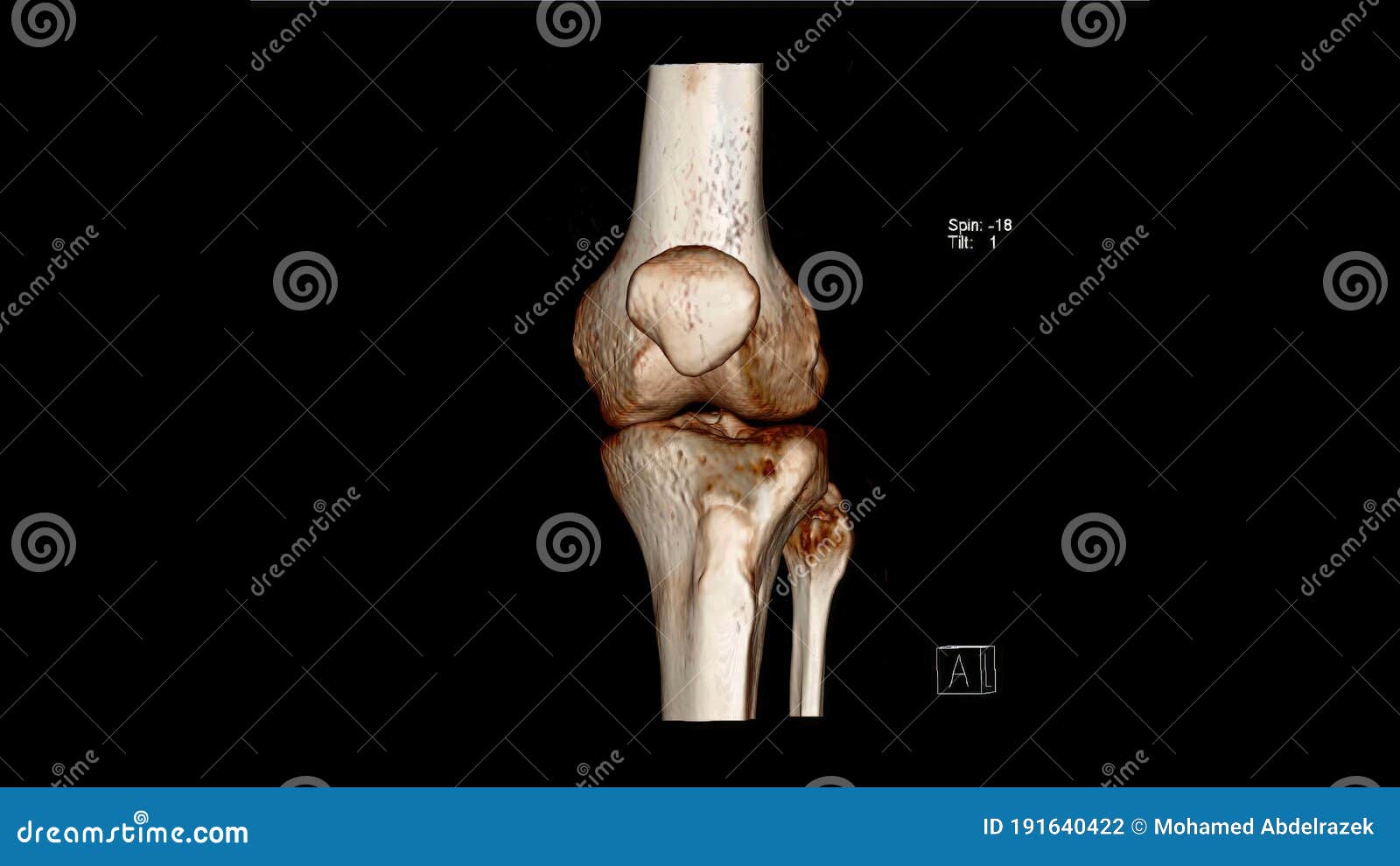 Computed Tomography Volume Rendering Examination of the Knee Joint CT ...