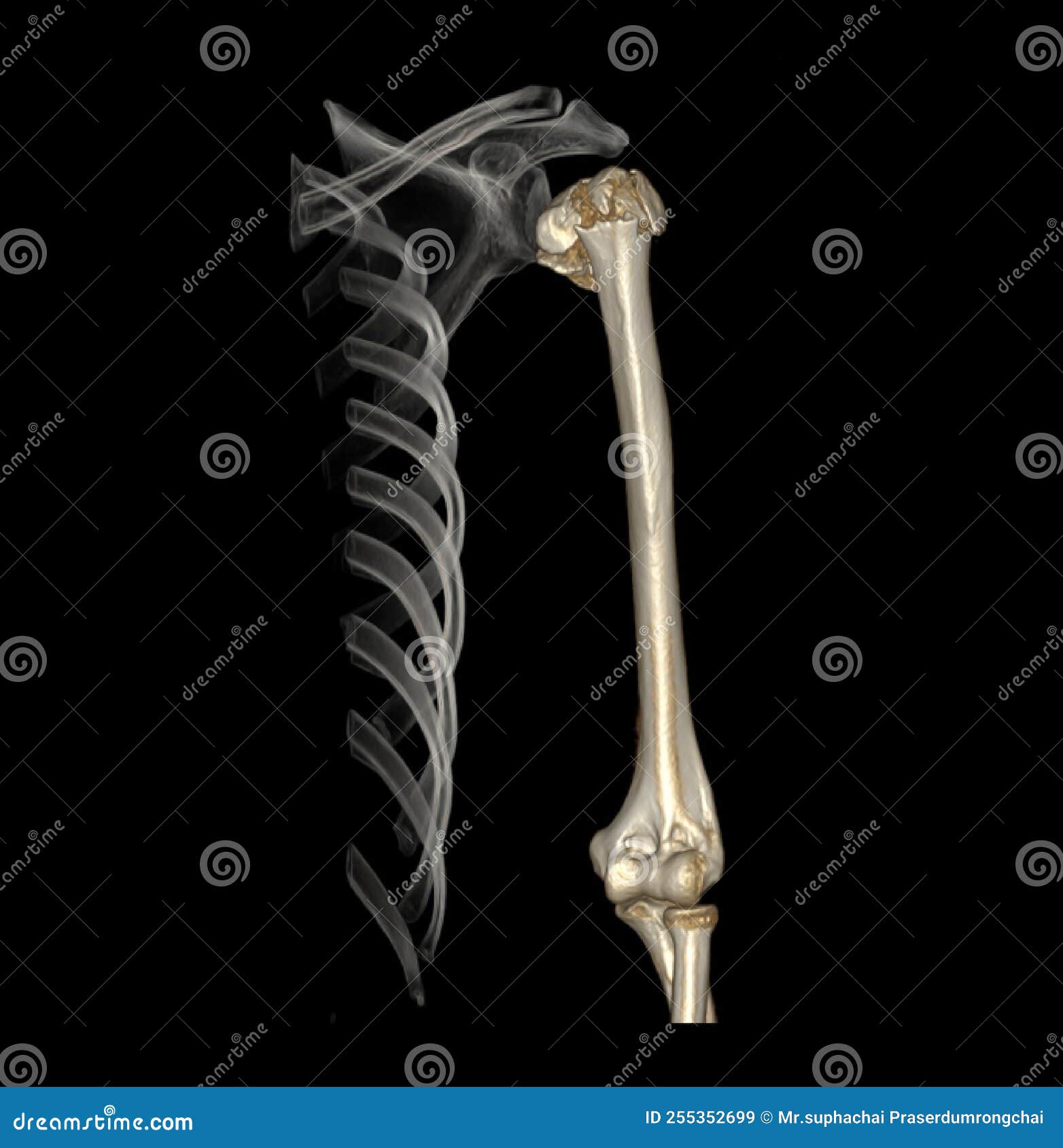 CT Scan of Shoulder Joint and Humerus Bone or Arm Stock Illustration ...