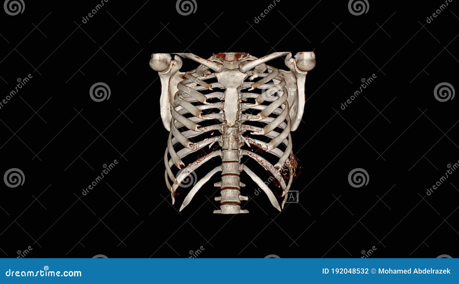 Computed Tomography Volume Rendering Examination of the Thoracic Cage ...