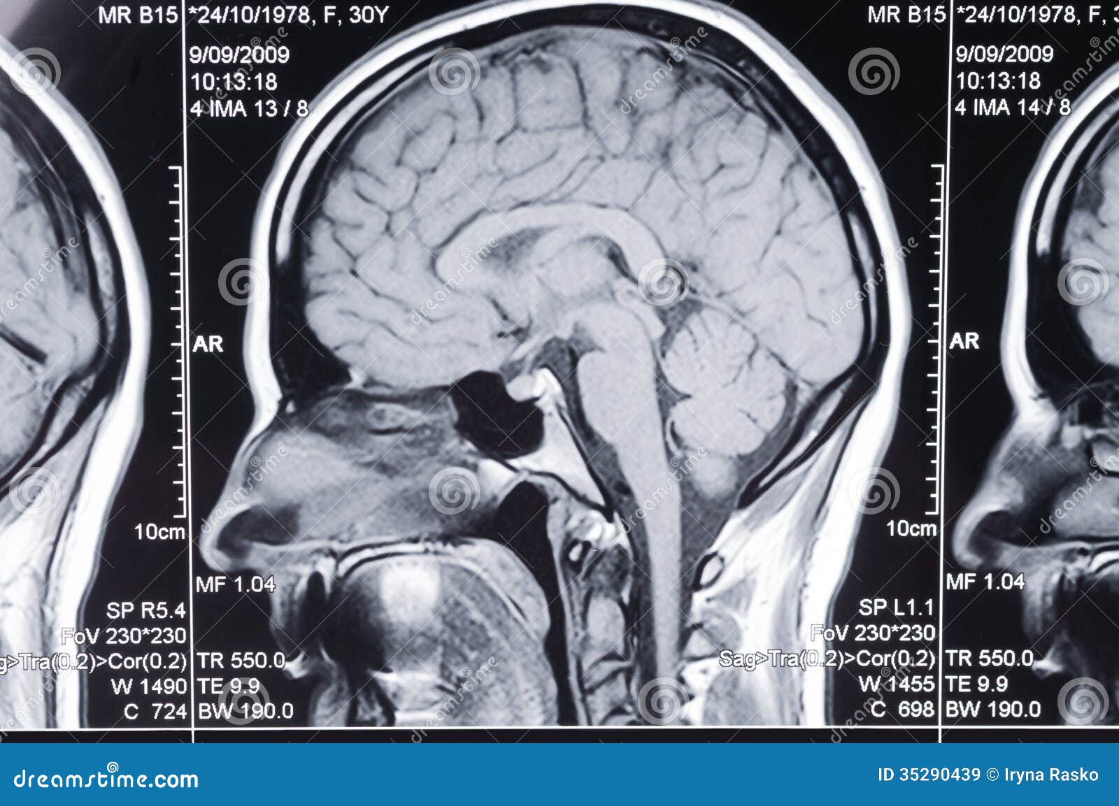 Computer Axial Tomography Scan (CAT) of a Head Stock Image - Image of ...