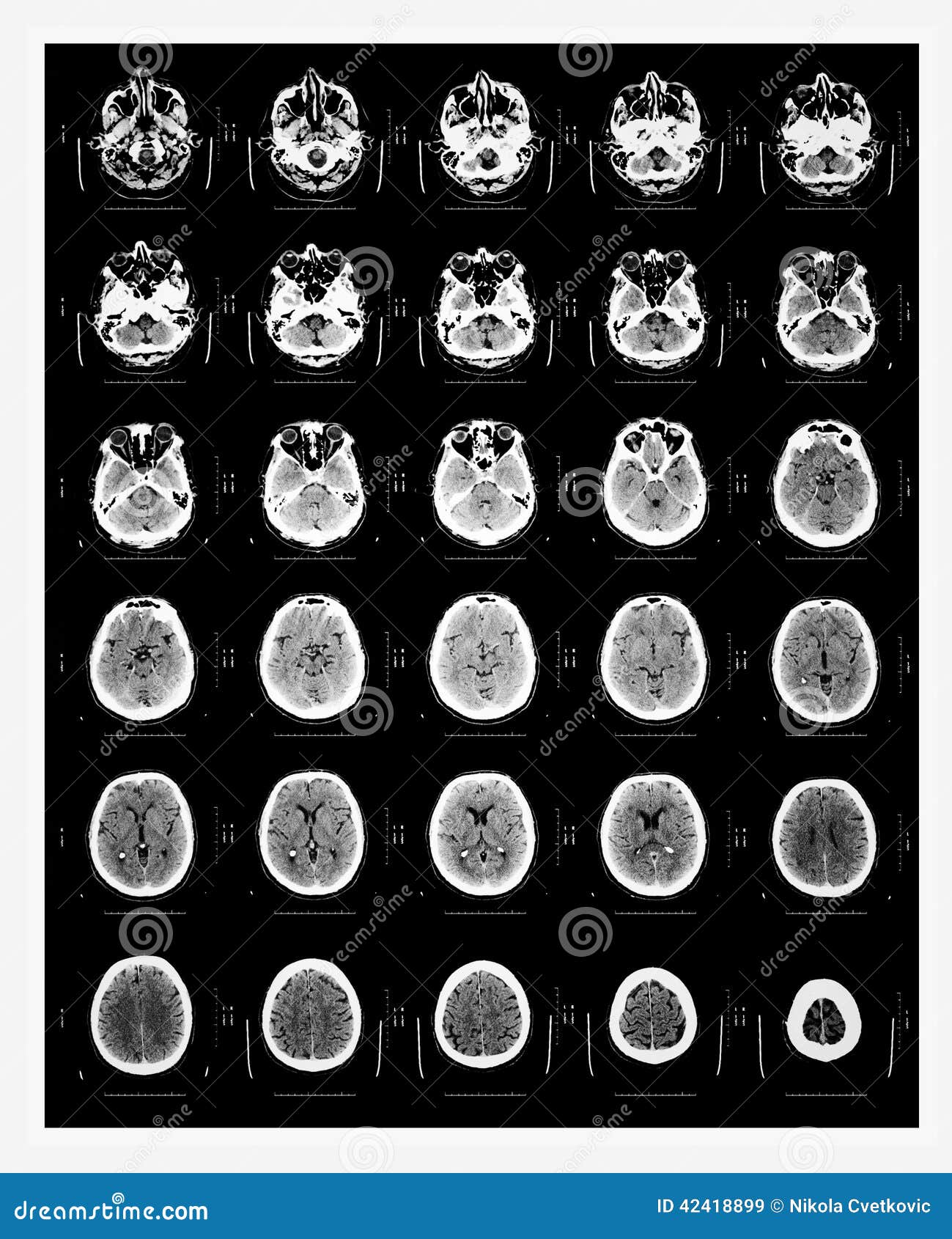 Computer Axial Tomography Scan (CAT Scan) Stock Image - Image of ...