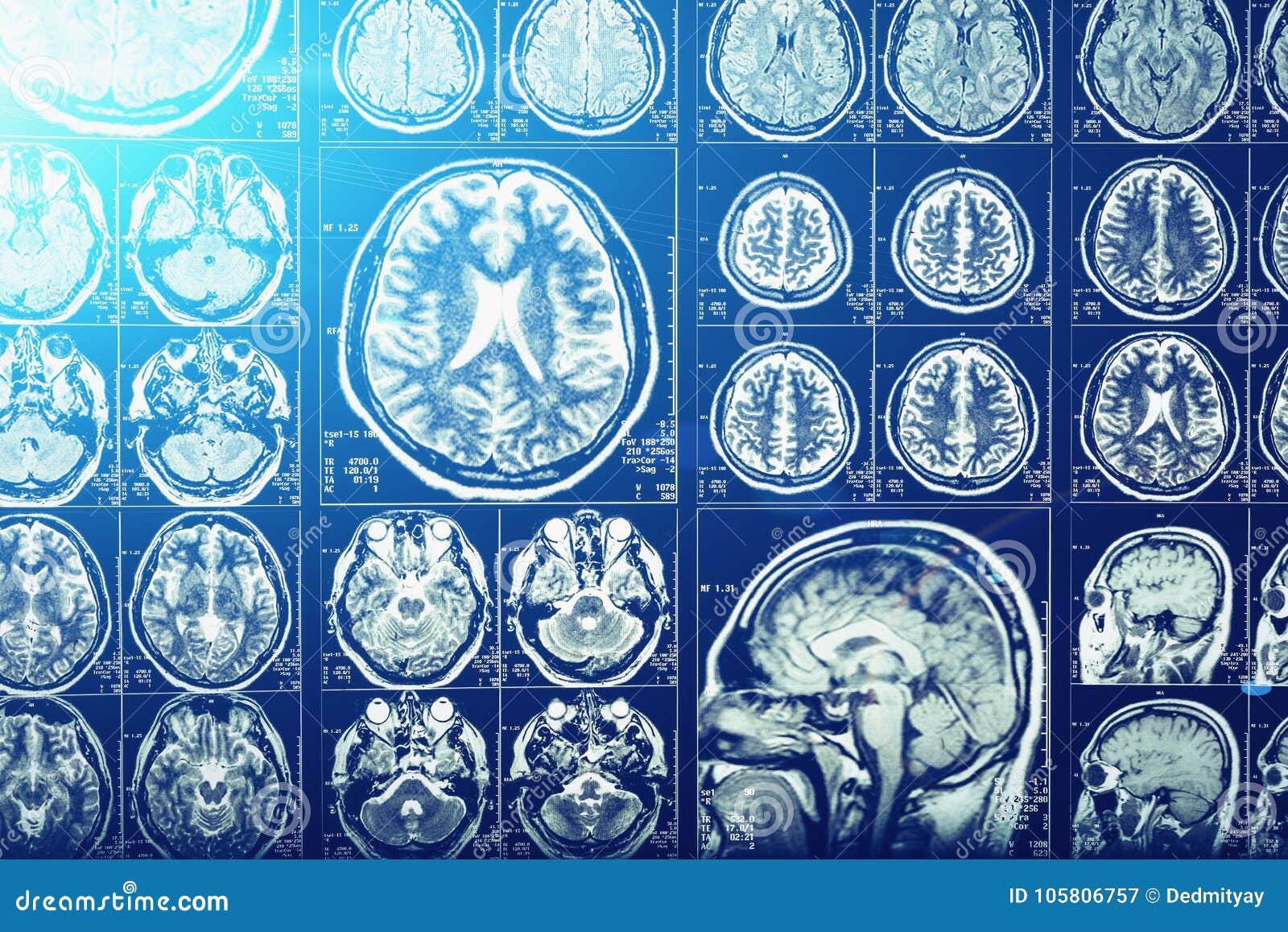 Computer Head Tomography, X-Ray Brain or Scull Scan Image, Blue Light ...