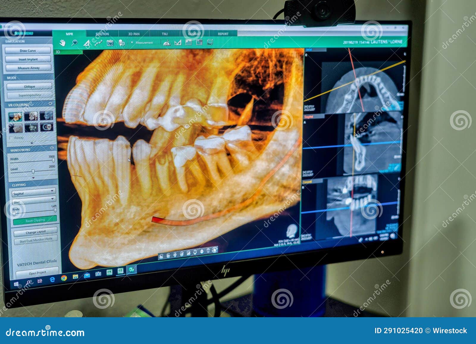 A Computer Monitor Displaying a Mouth with a Tooth Model in Front of it ...