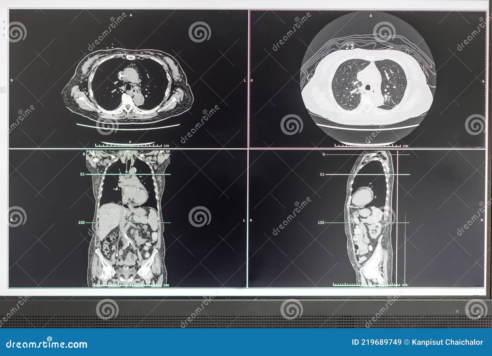 Computer Screen Showing MRI, CT Image Scan of the Brain. CT Whole ...