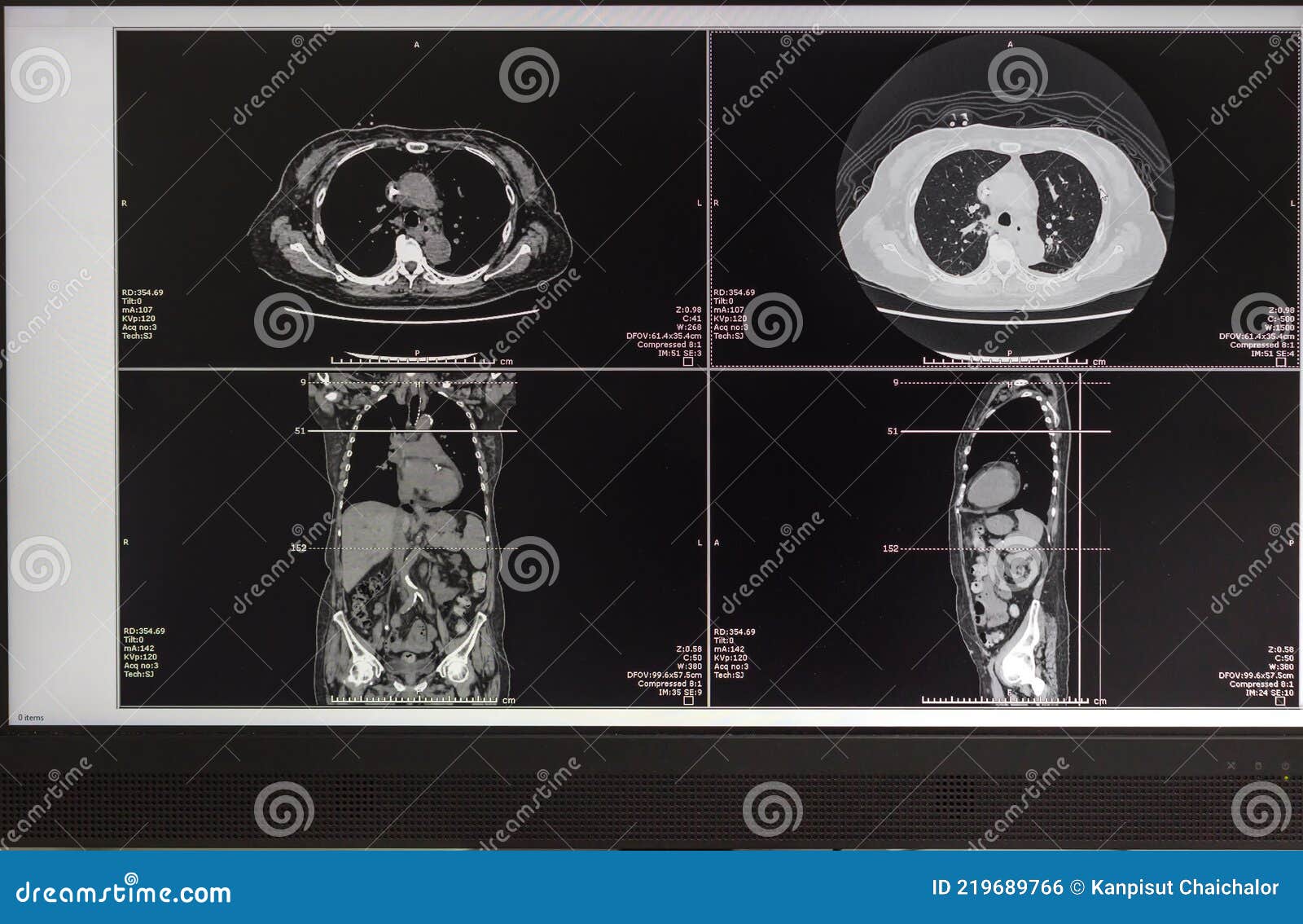 Computer Screen Showing MRI, CT Image Scan Of The Brain. CT Whole ...