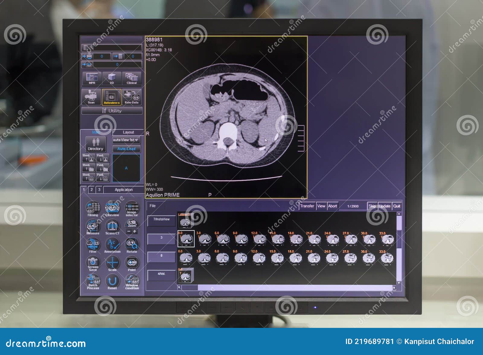 Computer Screen Showing MRI, CT Image Scan of the Brain. CT Whole ...