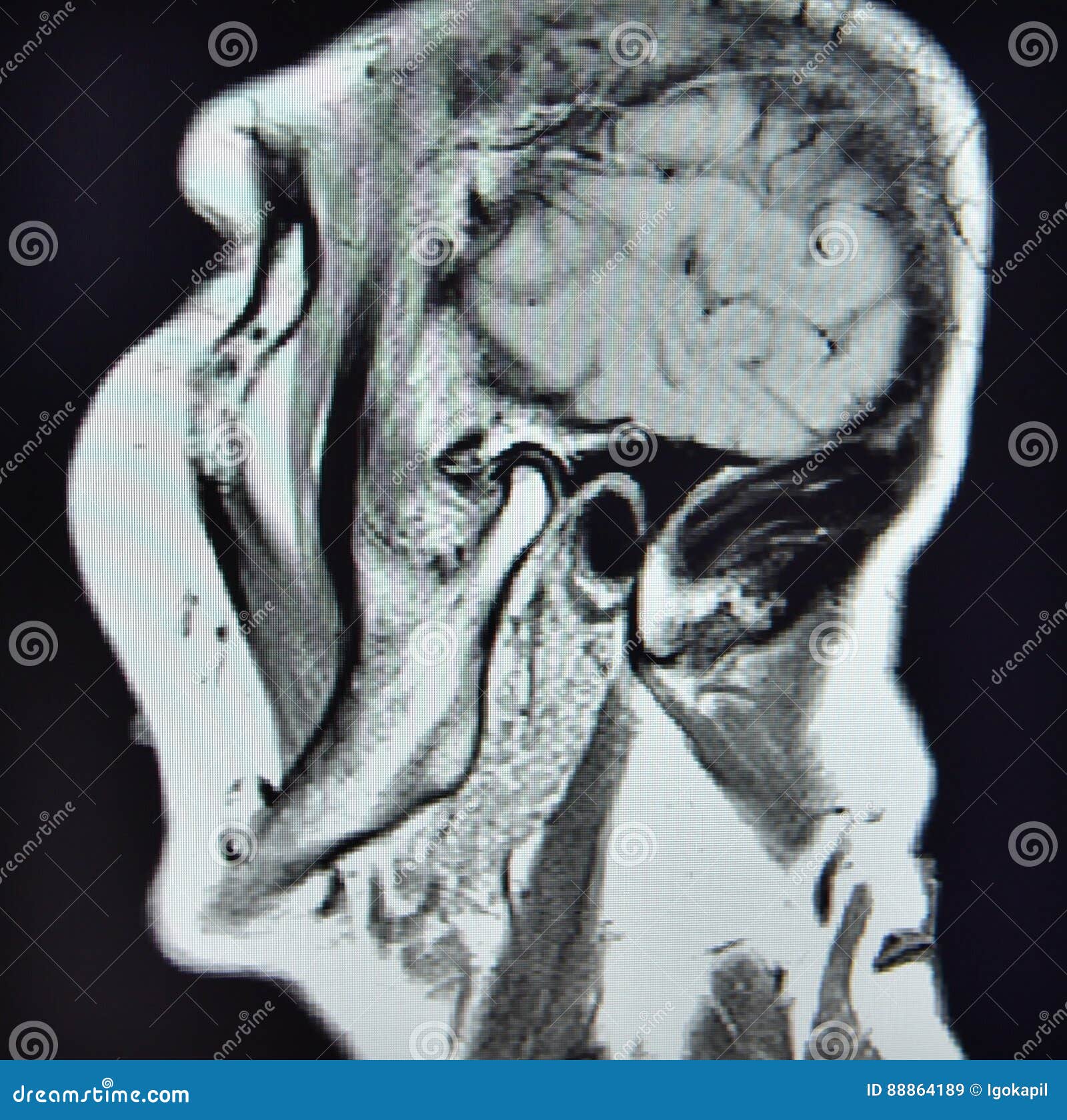 Temporamandibular Joint Pathology Ct Diagnostic Stock Image - Image of ...