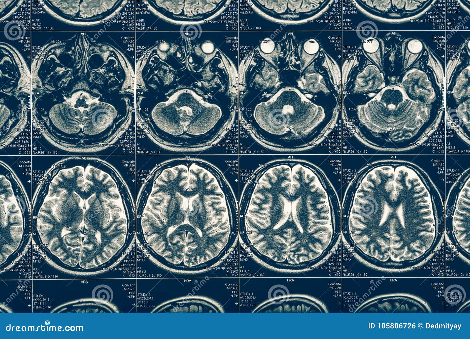 Computer Tomography X-Ray Brain Scan Image, Internal Hydrocephalus ...