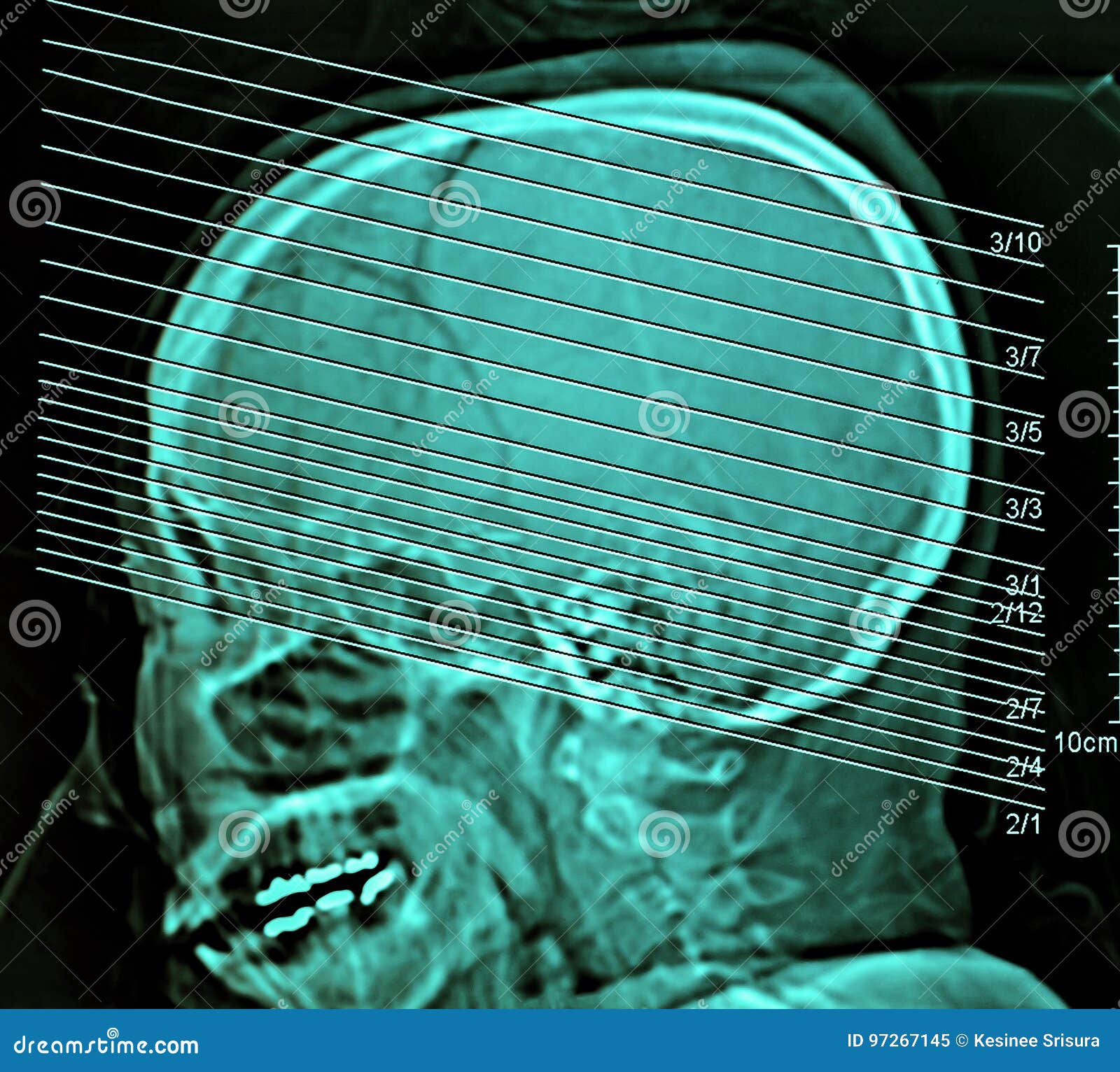 Human Brain Ct Scan Stock Images - Download 519 Royalty Free Photos