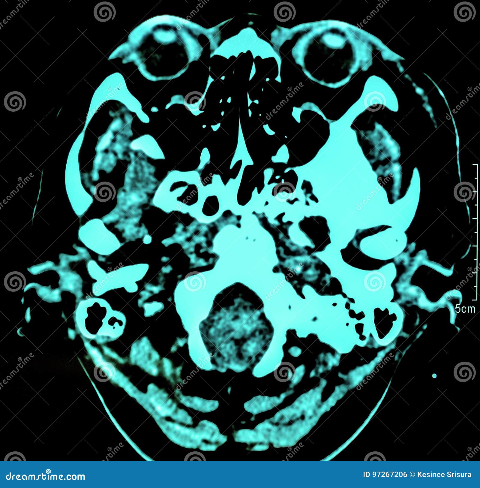 Computerized Film X-ray Tomography Of Human Brain, CT Scan Royalty-Free ...