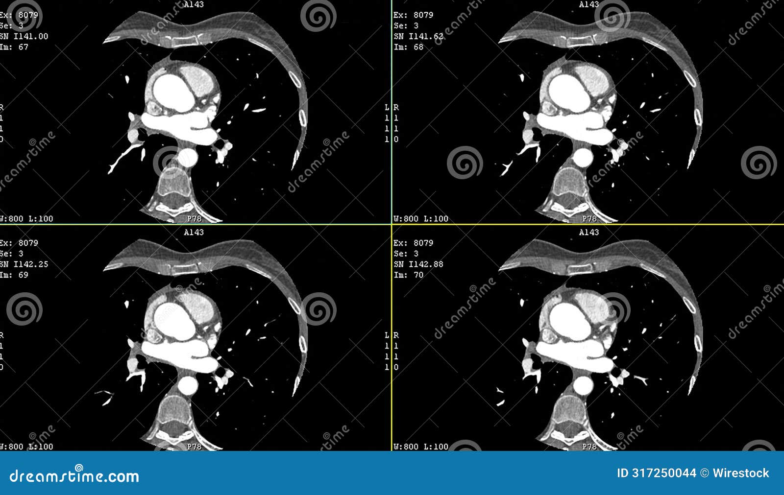 Computerized Tomography CT Coronary Angiogram. Axial Contrast of the ...