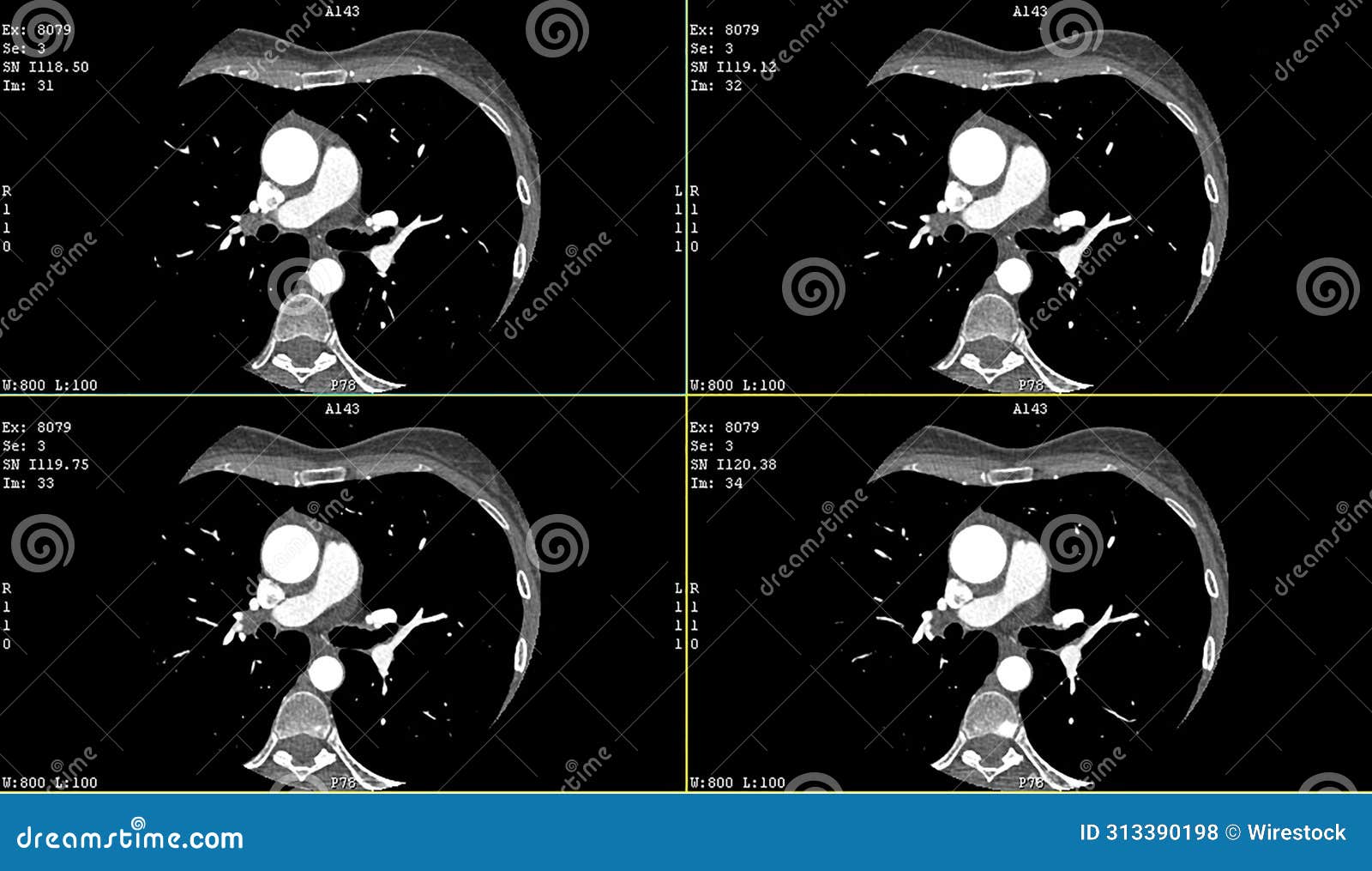 Computerized Tomography CT Coronary Angiogram Stock Photo - Image of ...