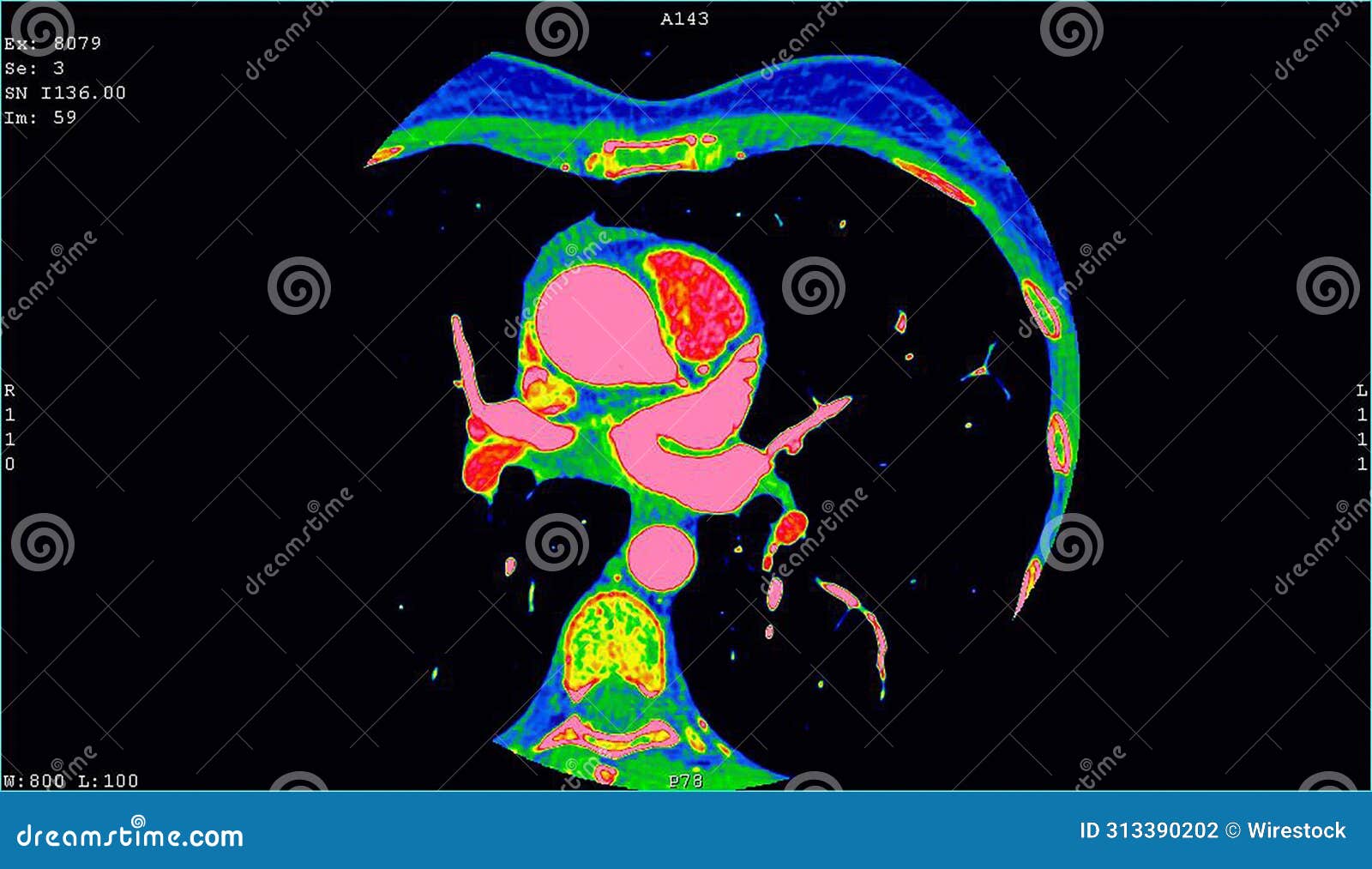 Computerized Tomography CT Coronary Angiogram Stock Photo - Image of ...