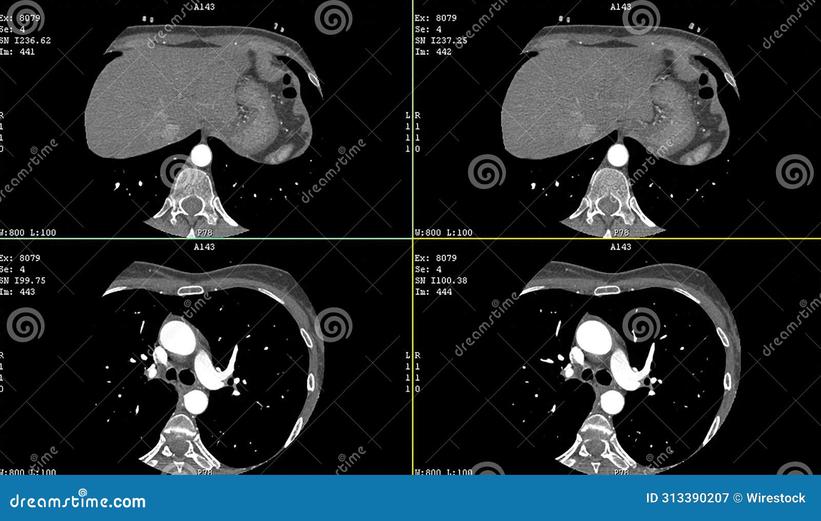 Computerized Tomography CT Coronary Angiogram Stock Image - Image of ...