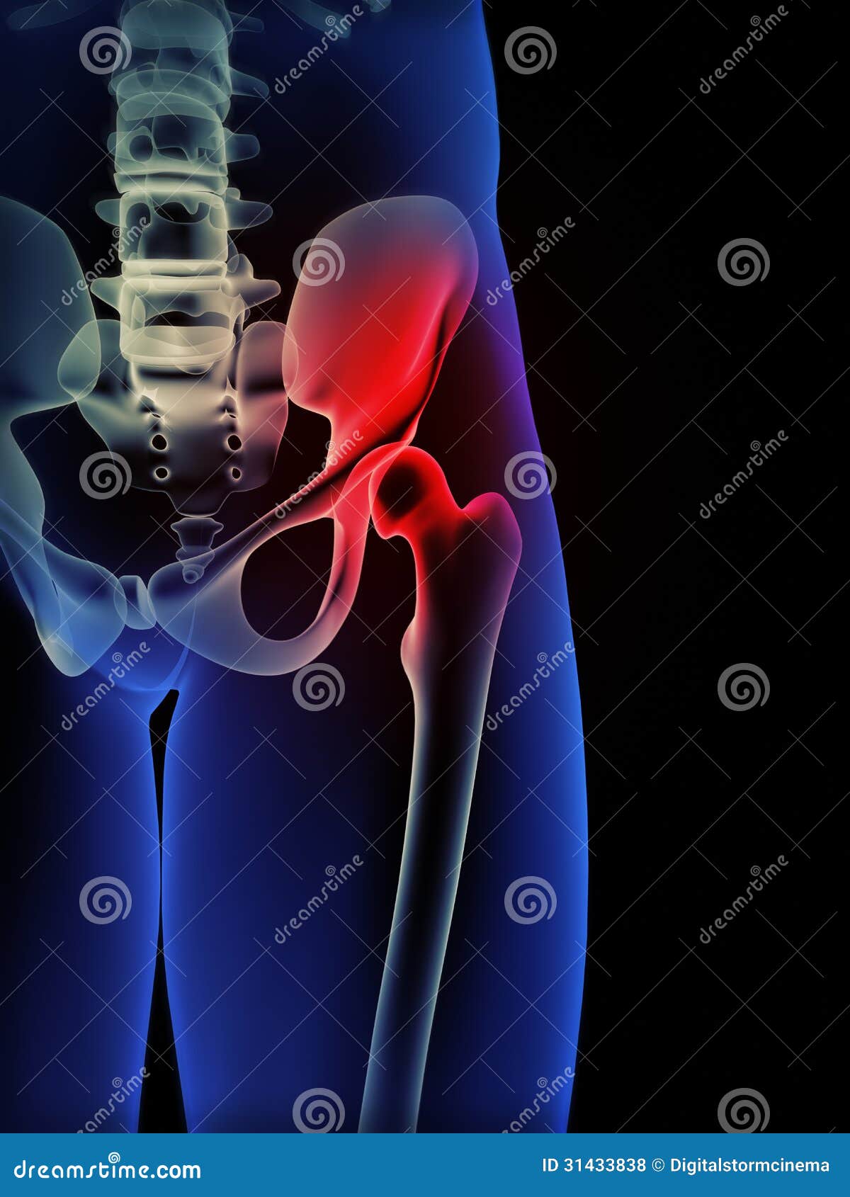 Conceito Anca Humano Da Dor Ilustração Stock - Ilustração de sintoma ...