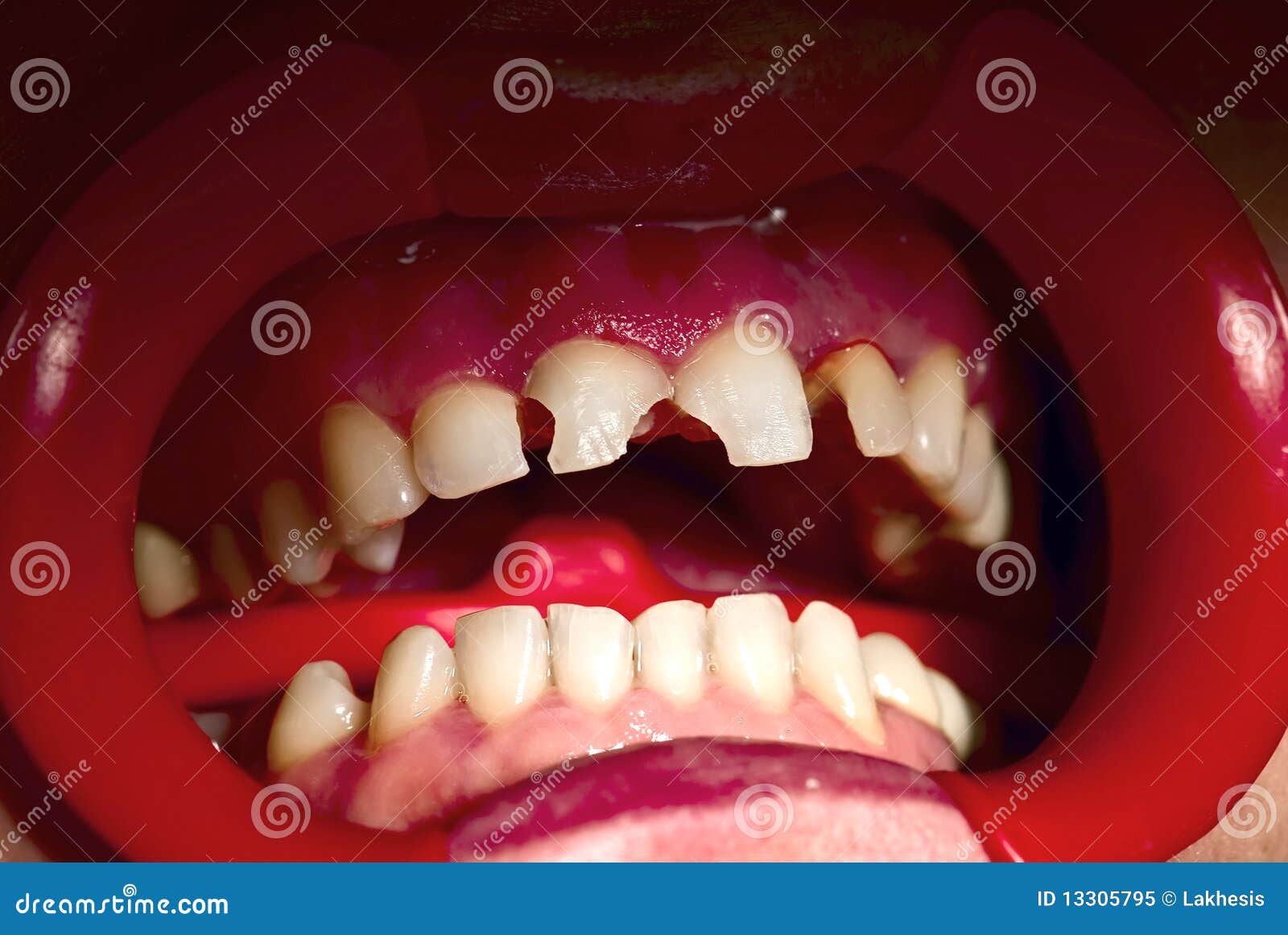 Concept: Bad Teeth Condition. Stock Image - Image of dentistry, hygiene ...