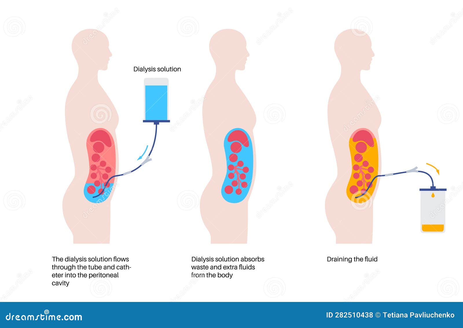Concept De Dialyse Péritonéale Illustration De Vecteur Illustration