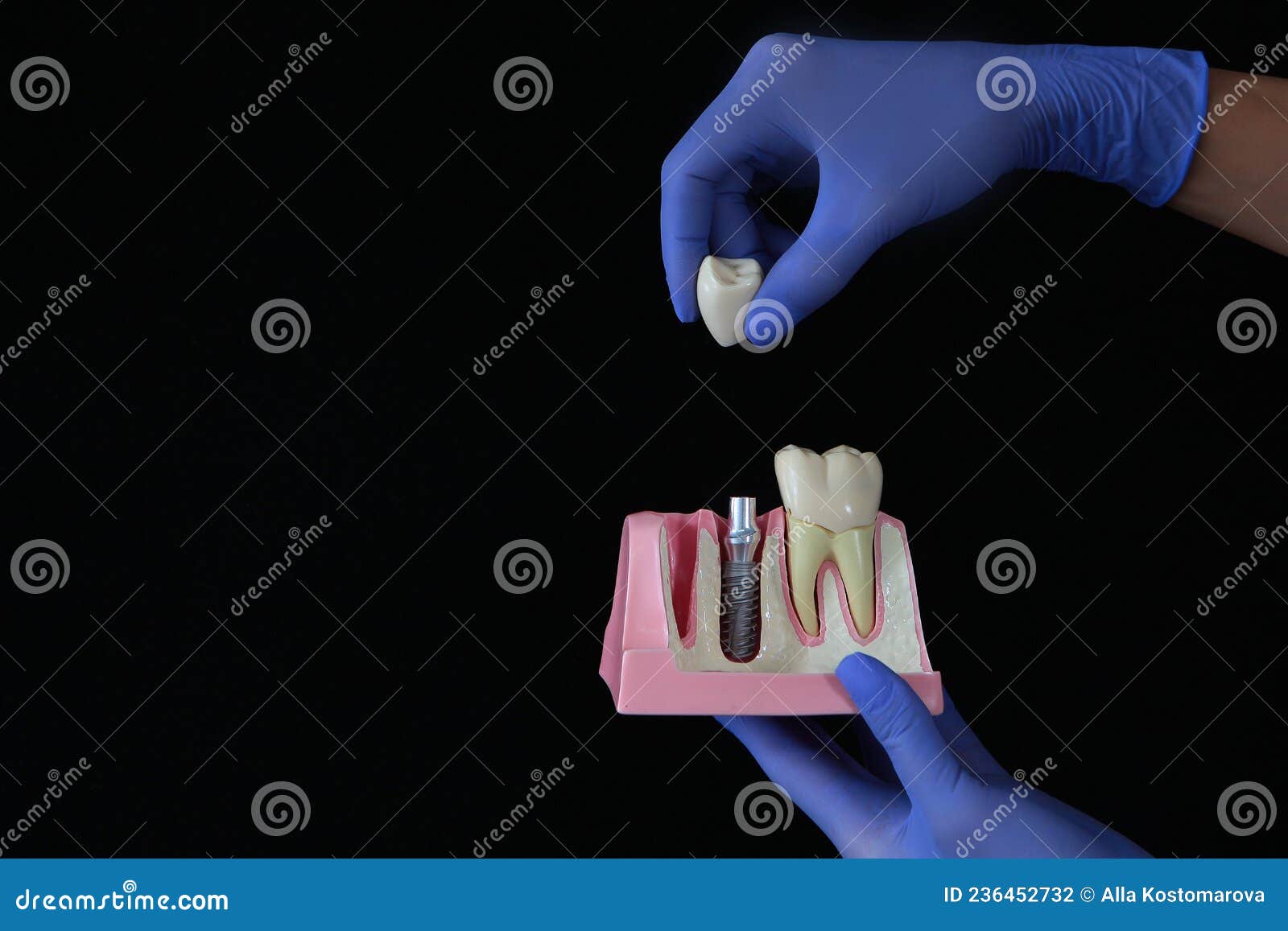 The Concept of Installing Dental Implants. Visual Demonstration on ...