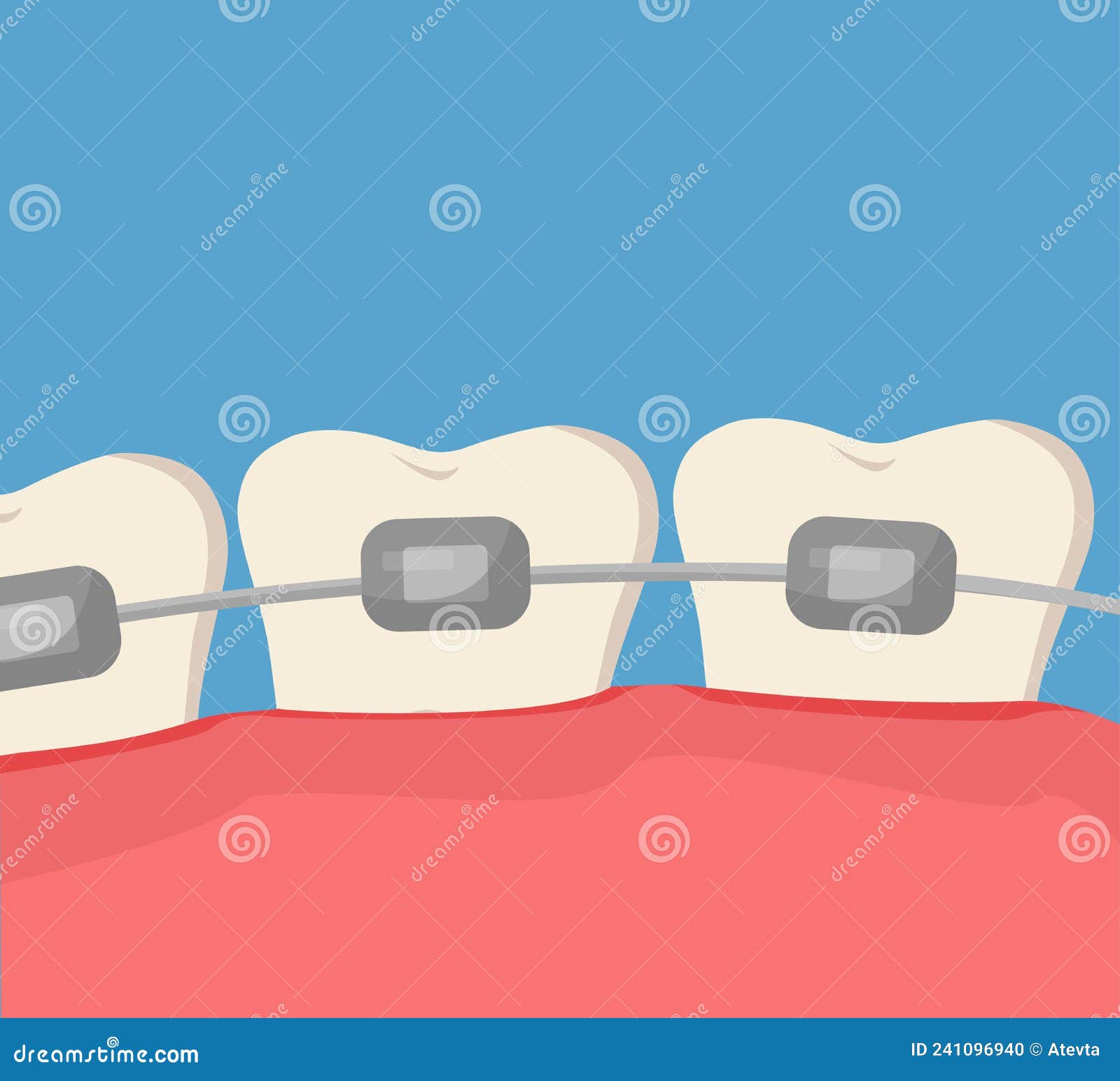 The Concept of Teeth Alignment with Braces. Simple Teeth in a Row ...