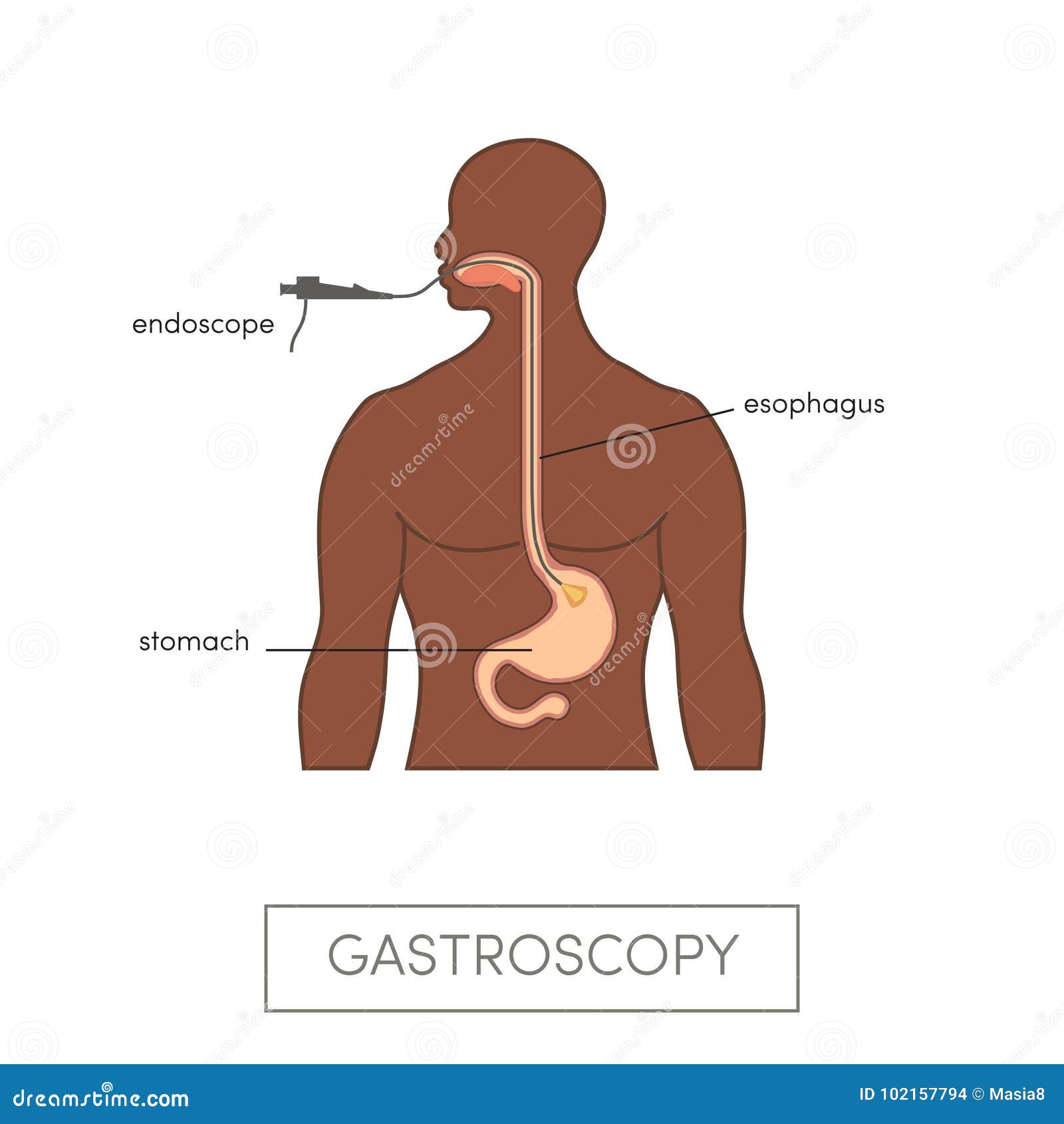 Concepto Del Gastroscopy Del Vector Stock de ilustración - Ilustración ...