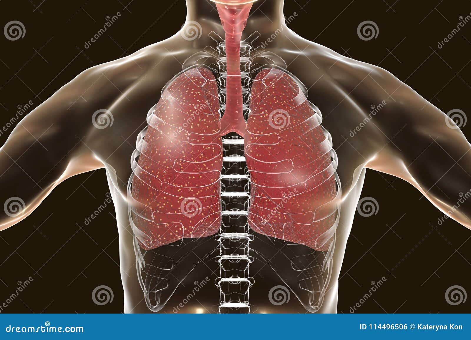 Concepto Médico De La Tuberculosis Miliar Stock de ilustración ...