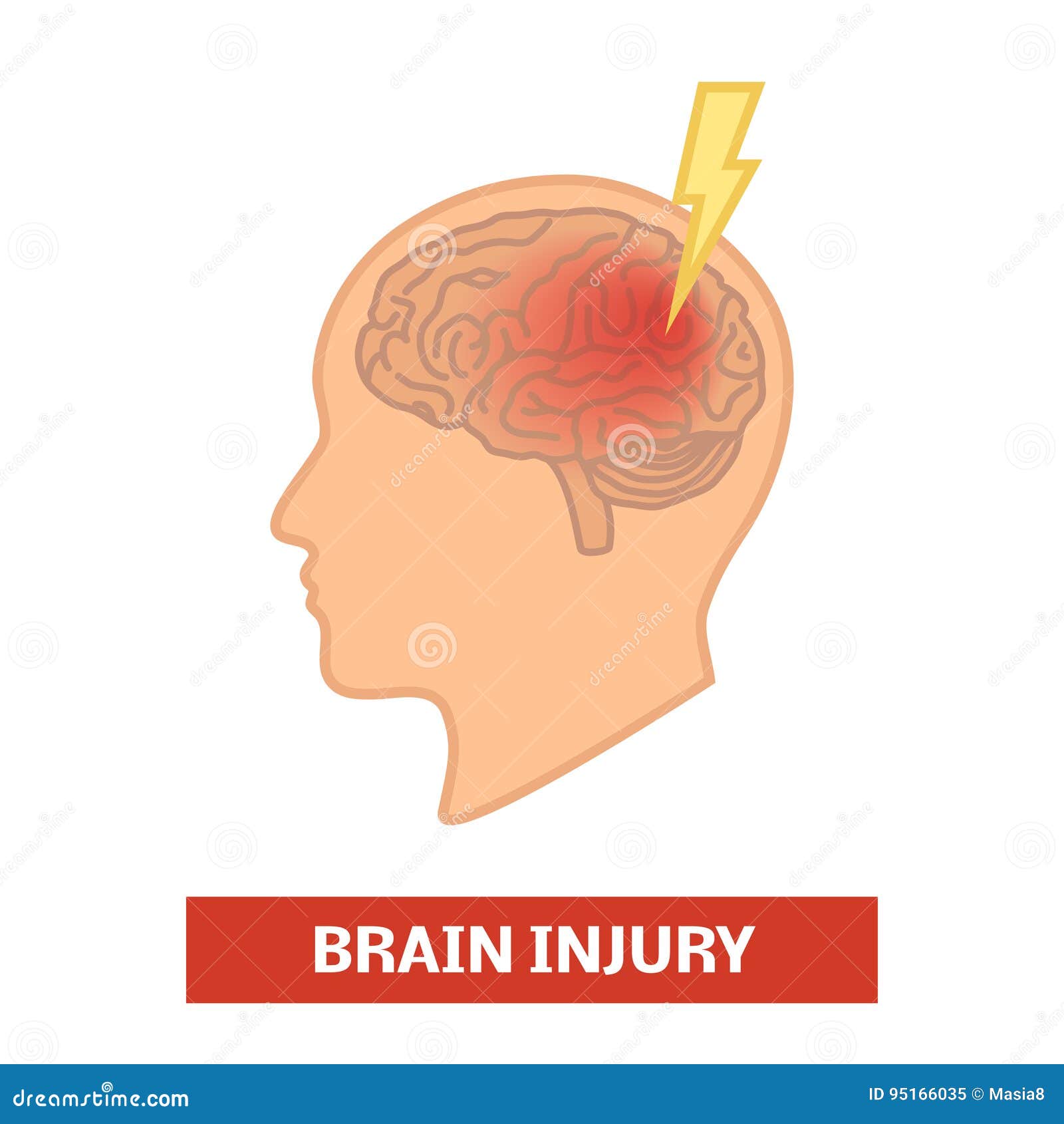 Concetto Del Trauma Cranico Illustrazione di Stock - Illustrazione di ...