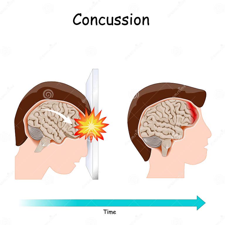 Concussion. Brain after Head Trauma Stock Vector - Illustration of ...