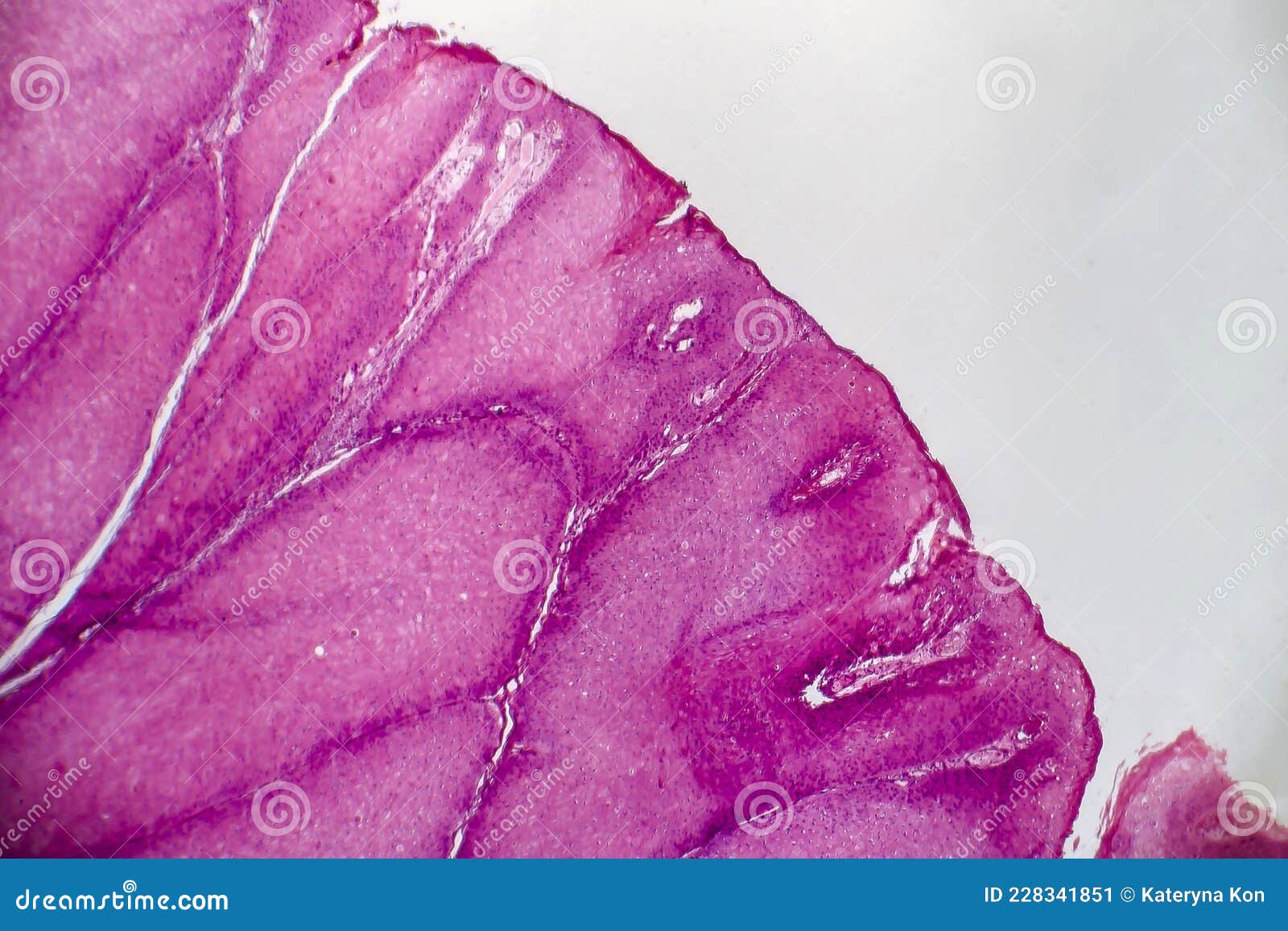 Condyloma Acuminatum, Also Known As Genital Warts, Light Micrograph ...