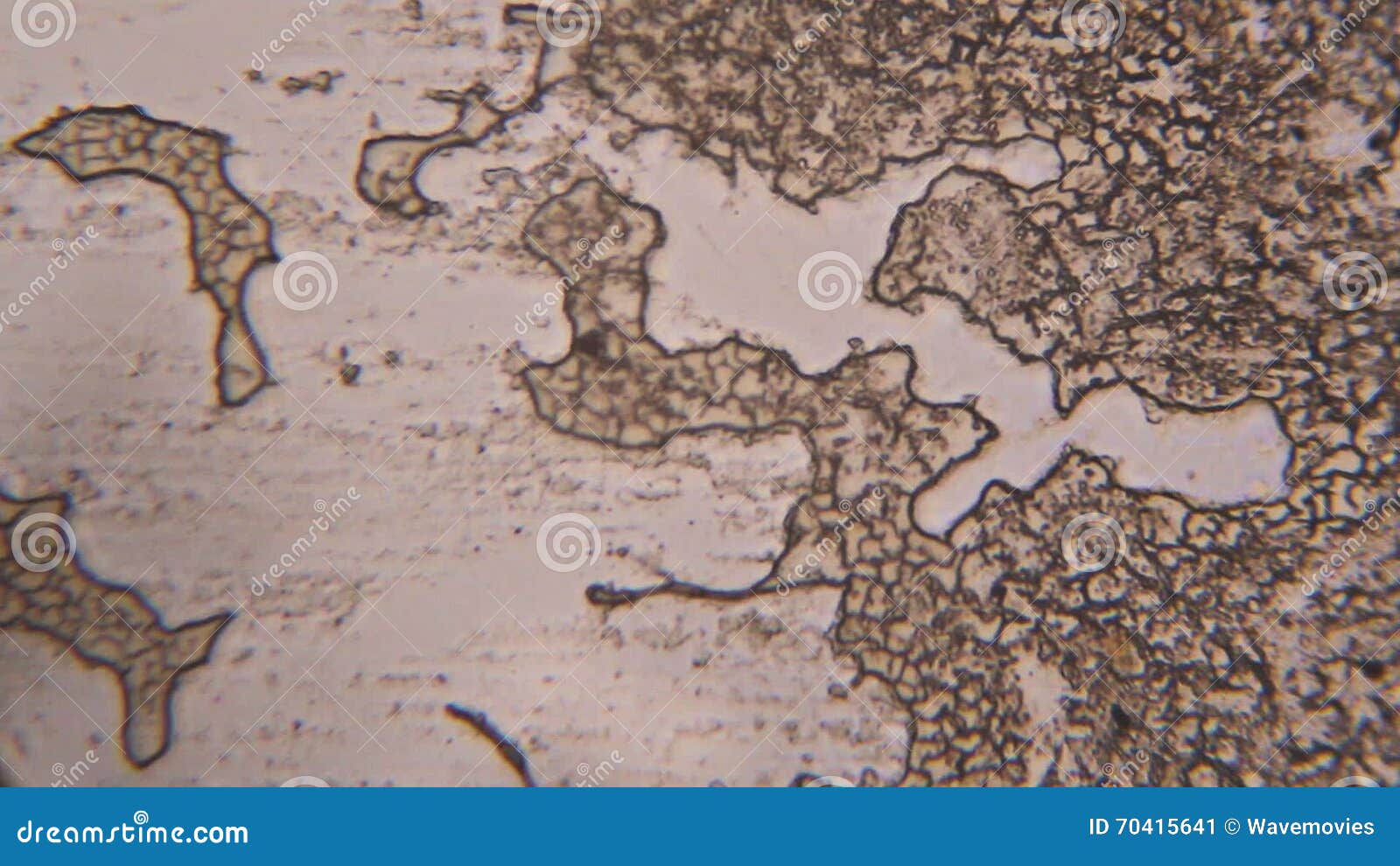 Congealed Blood Cells Under the Microscope Stock Video - Video of ...