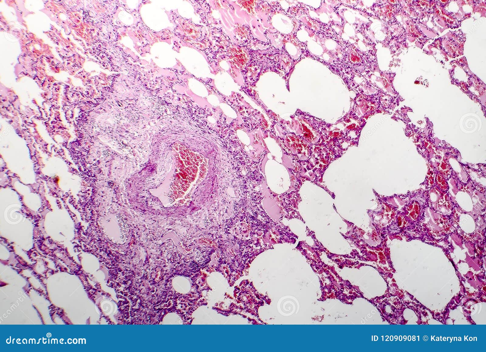 Congestione Polmonare Cronica Ed Edema Immagine Stock - Immagine di ...