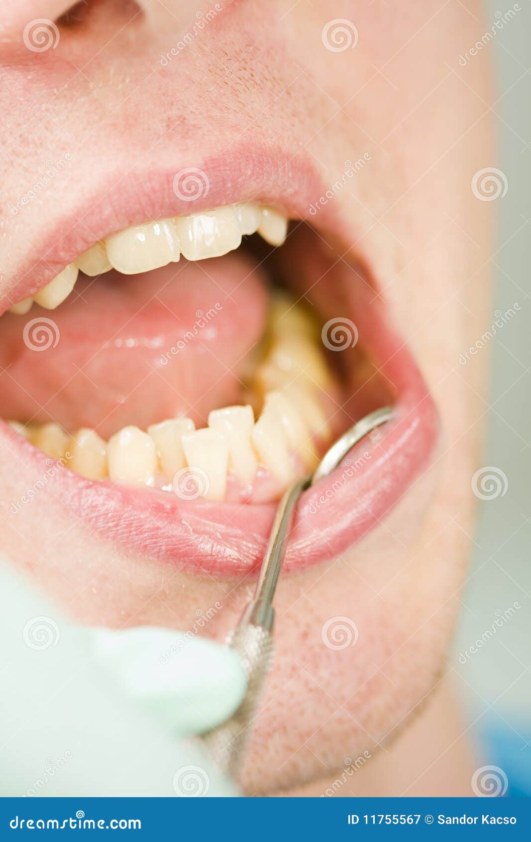 Congestioned teeth stock image. Image of denture, care - 11755567