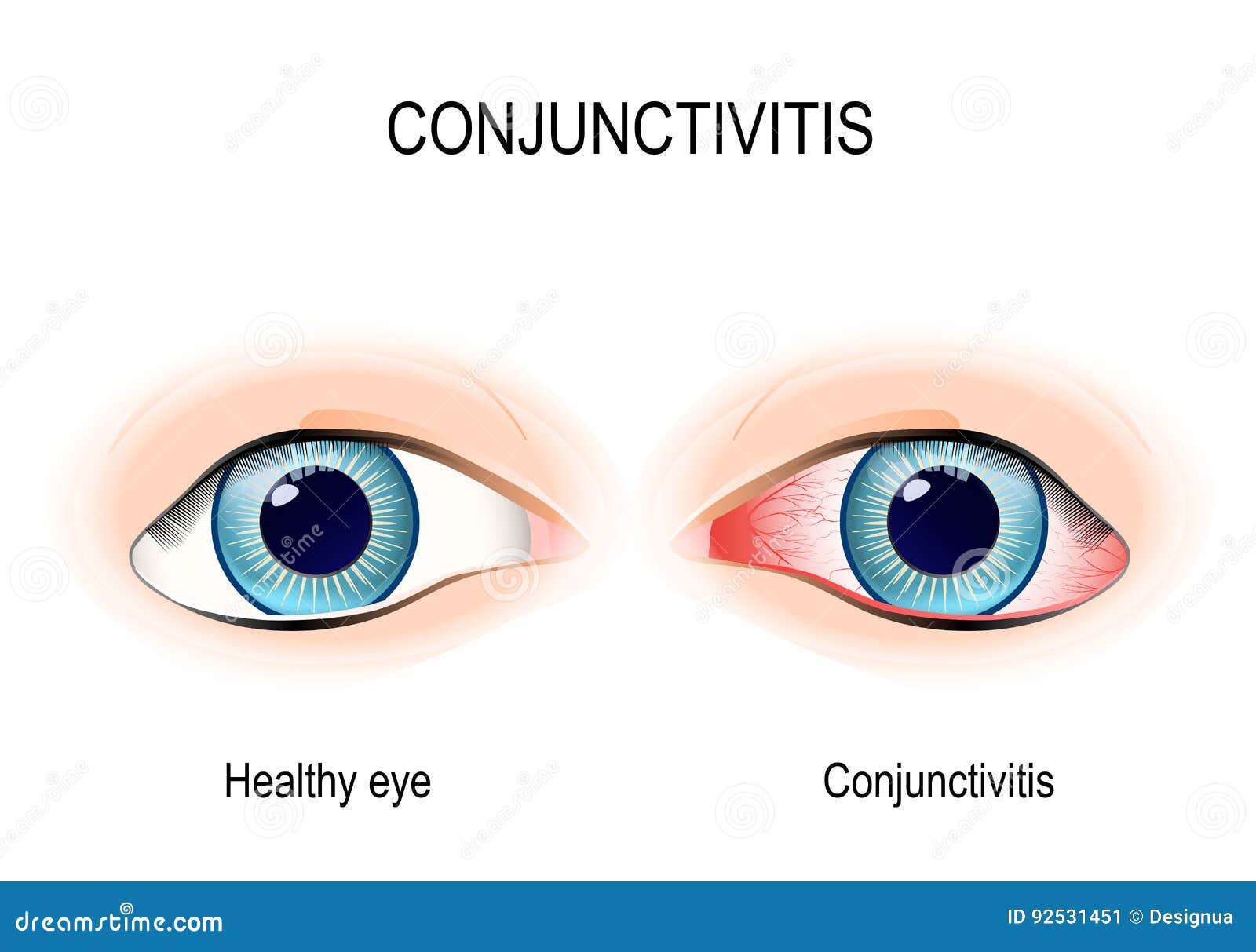 Congiuntivite illustrazione vettoriale. Illustrazione di sano - 92531451