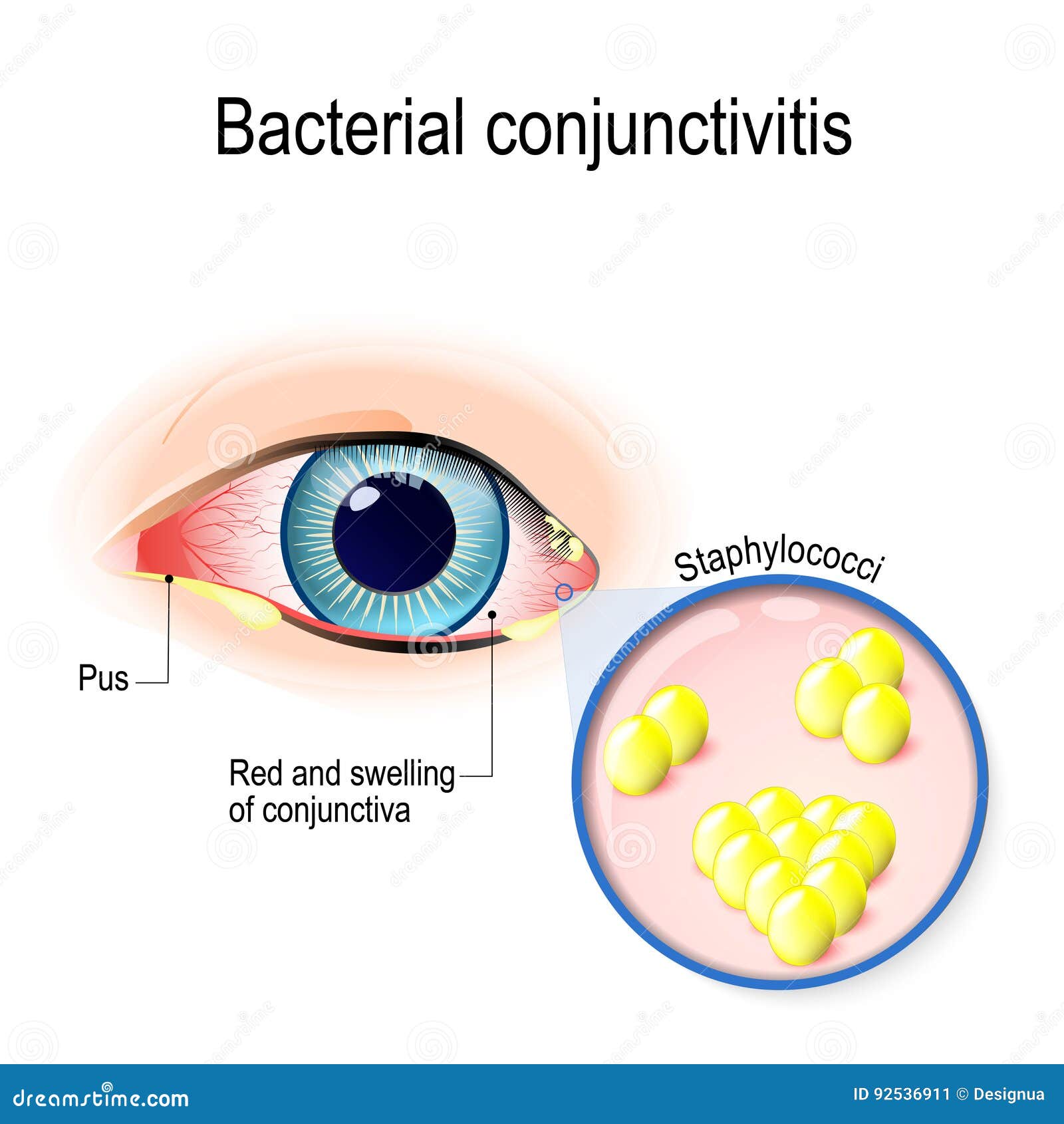 Conjonctivite bactérienne illustration de vecteur. Illustration du yeux ...