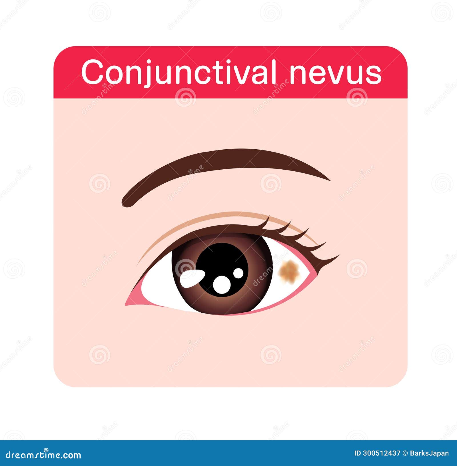 Conjunctival Cartoons, Illustrations & Vector Stock Images - 33 ...