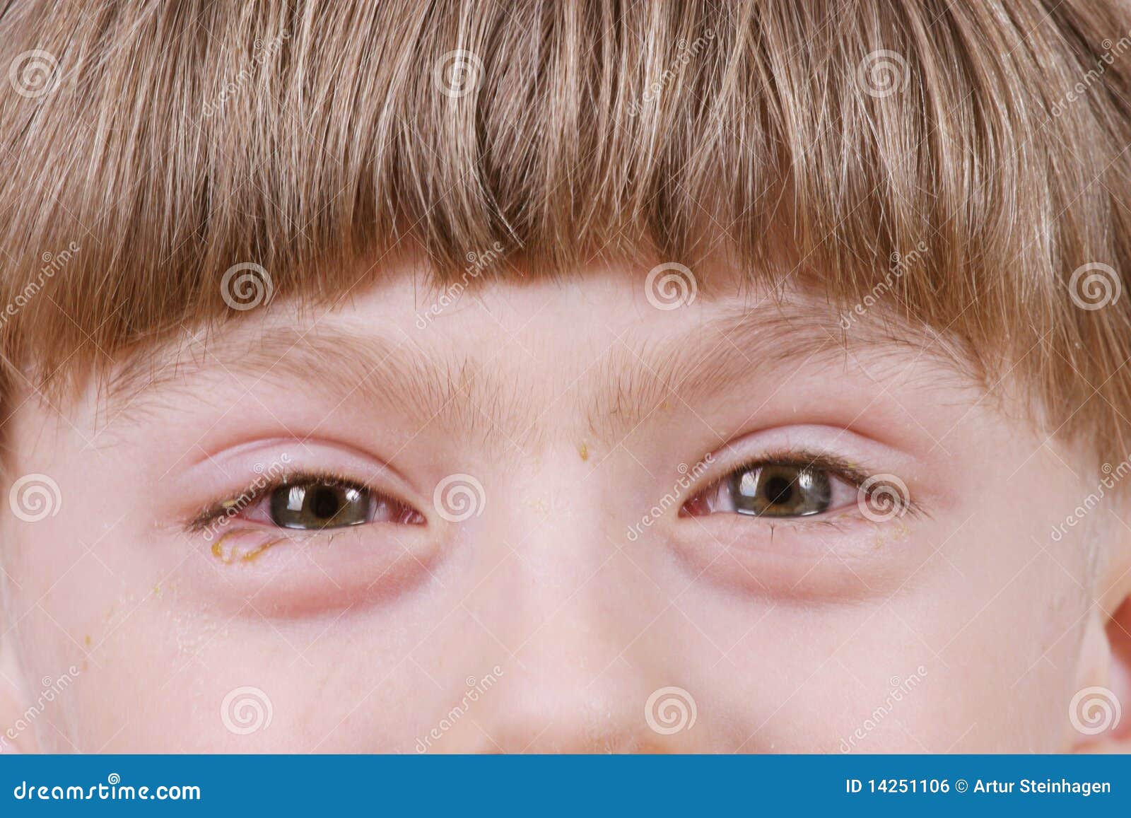 Conjunctivitis - Ill Allergic Eyes Stock Photo - Image of ...