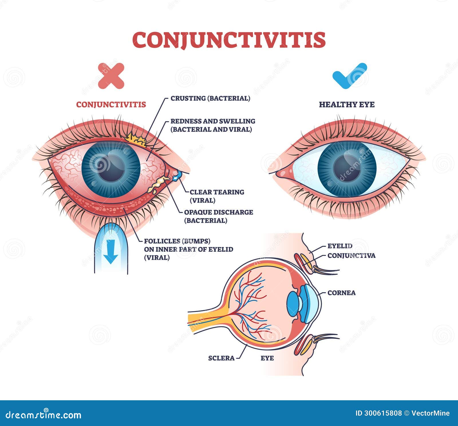 Conjunctivitis Or Pink Eye Medical Condition Explanation Outline Diagram Stock Vector