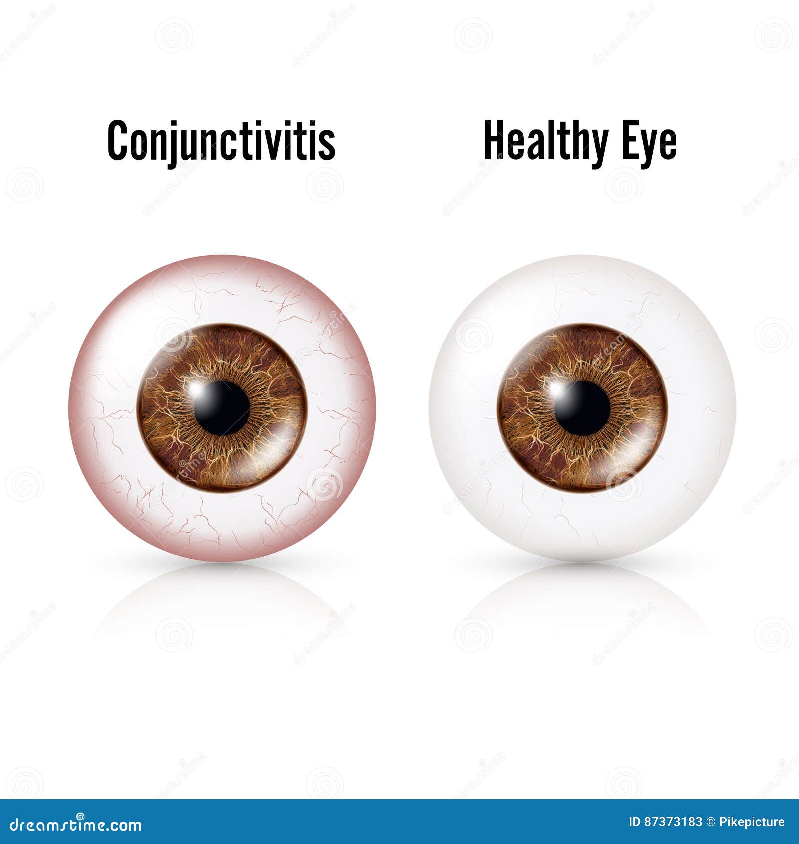 Conjunctivitis. Red Eye. Healthy Eye and Eyeball with Conjunctivitis ...