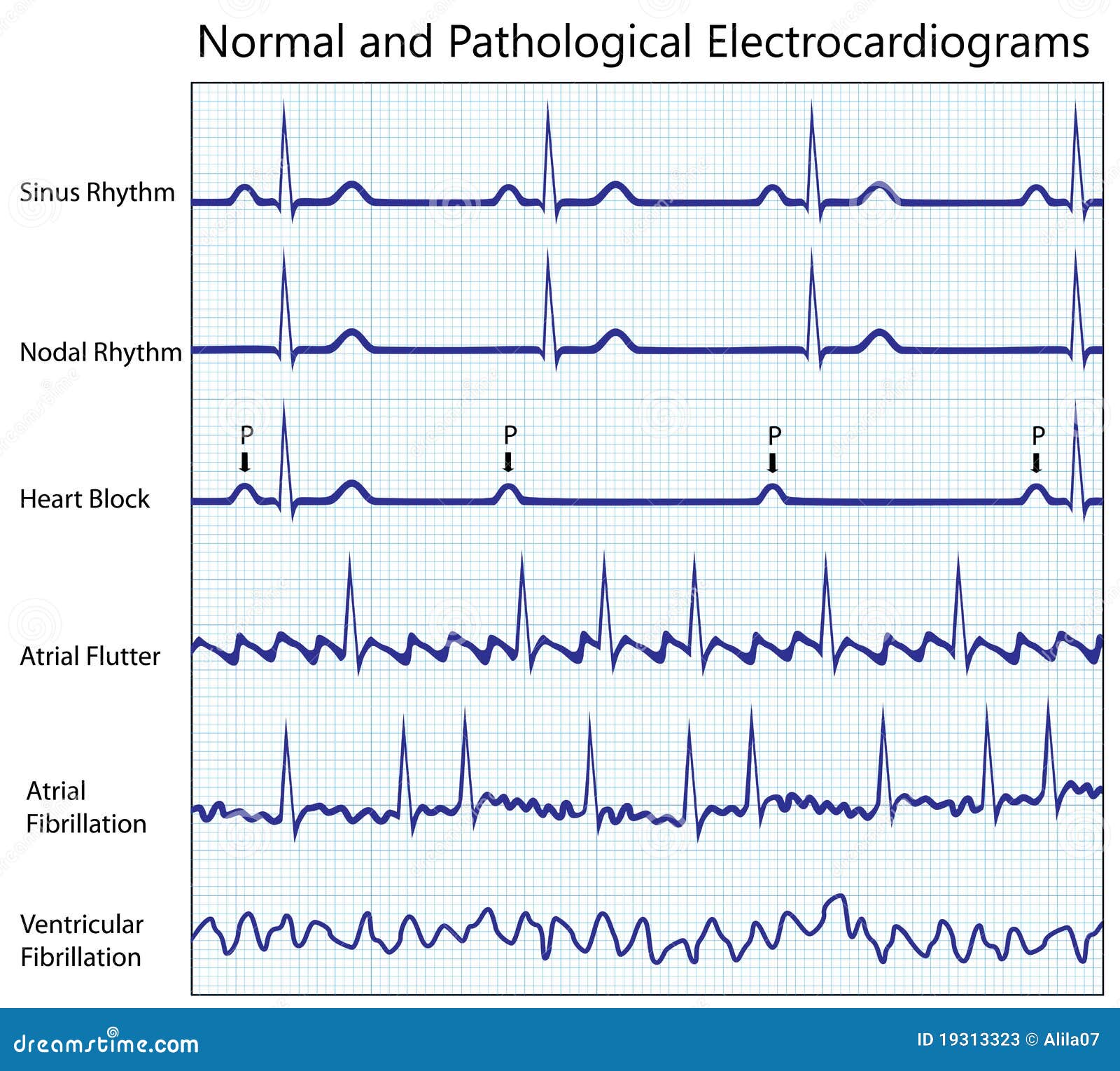 Conjunto de ECG ilustración del vector. Ilustración de ritmo - 19313323
