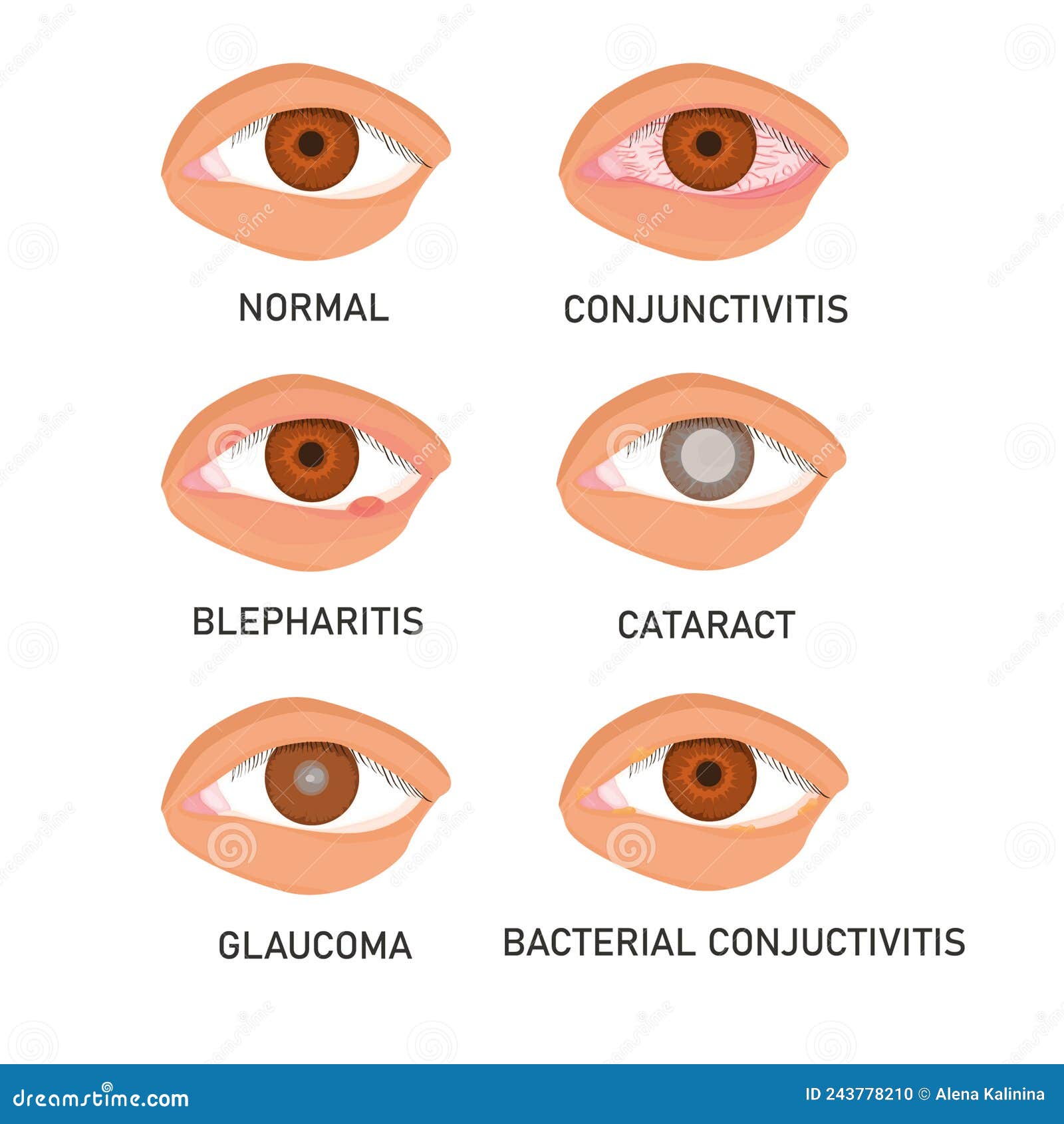 Conjunto De Enfermedades Oculares Más Frecuentes Aisladas Ilustración