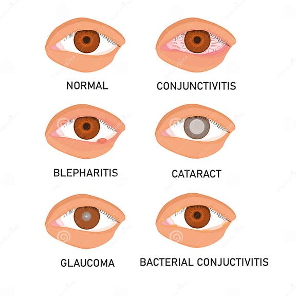 Conjunto De Enfermedades Oculares Más Frecuentes Aisladas Ilustración