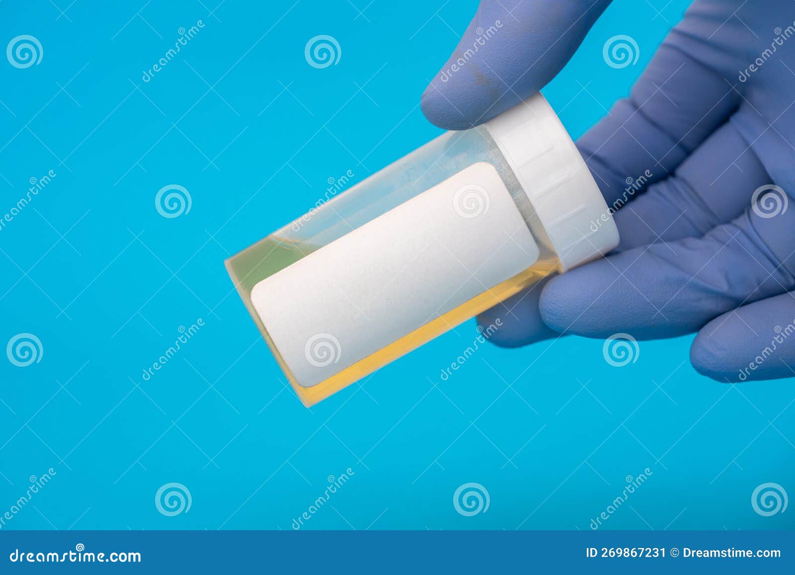 Container with a Urine Sample for Microbiological Laboratory Analysis ...