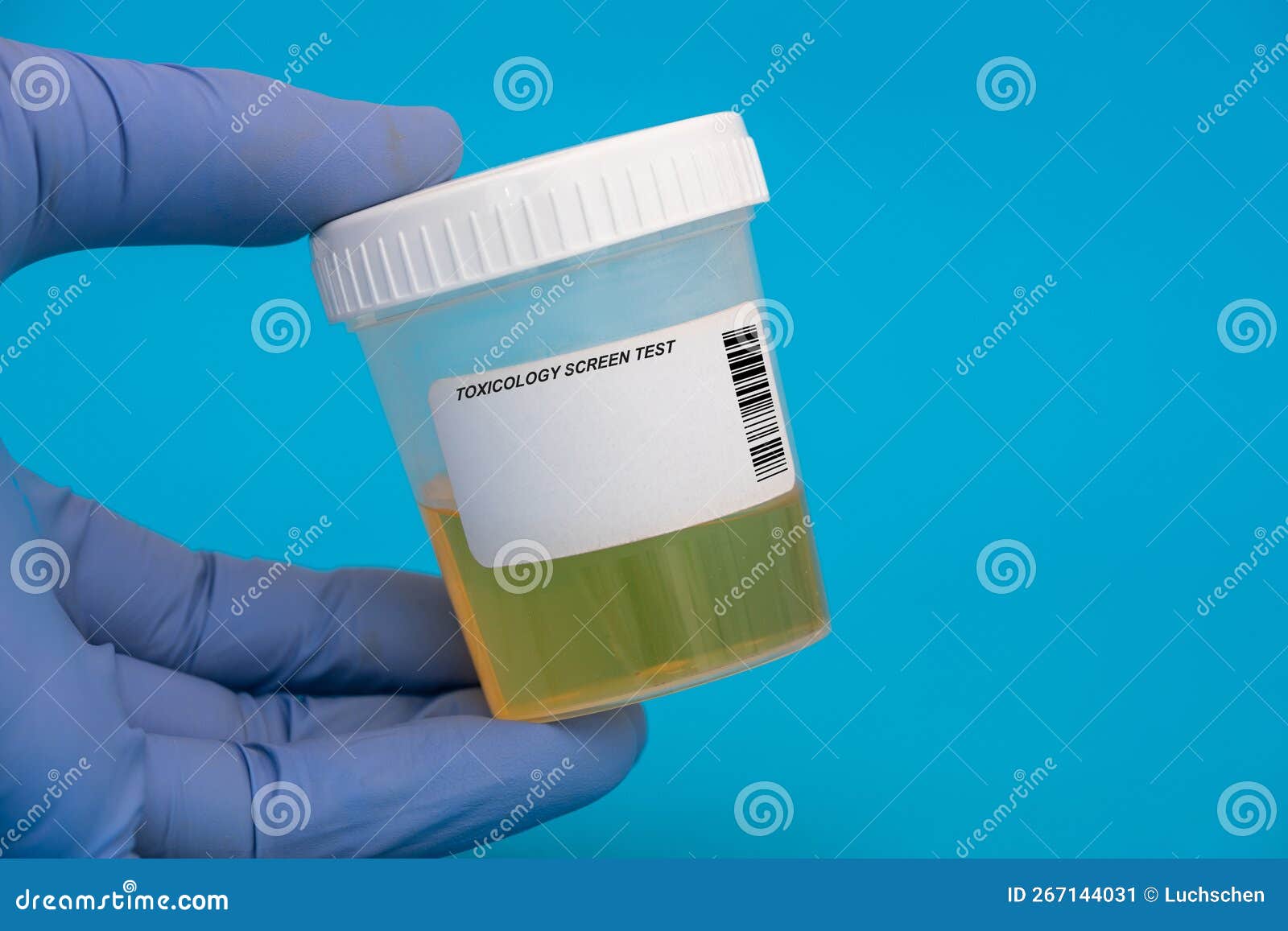 Container with a Urine Sample for Microbiological Laboratory Analysis ...