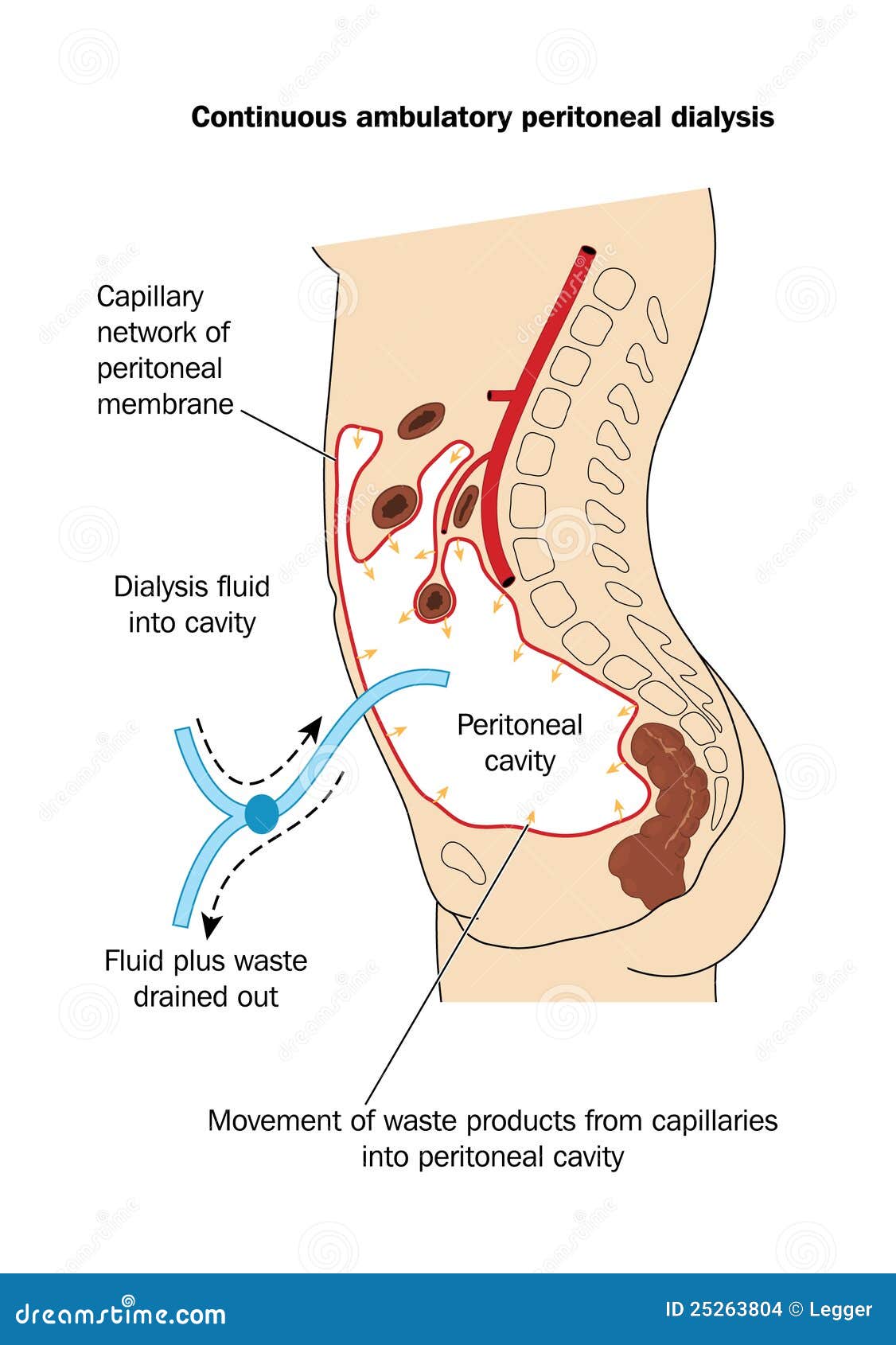 Continuous Ambulatory Peritoneal Dialysis Stock Vector - Illustration of dialysis, illness: 25263804