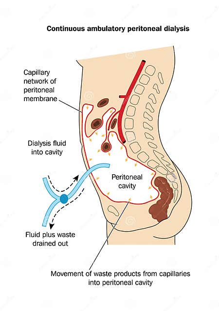Continuous Ambulatory Peritoneal Dialysis Stock Vector - Illustration ...
