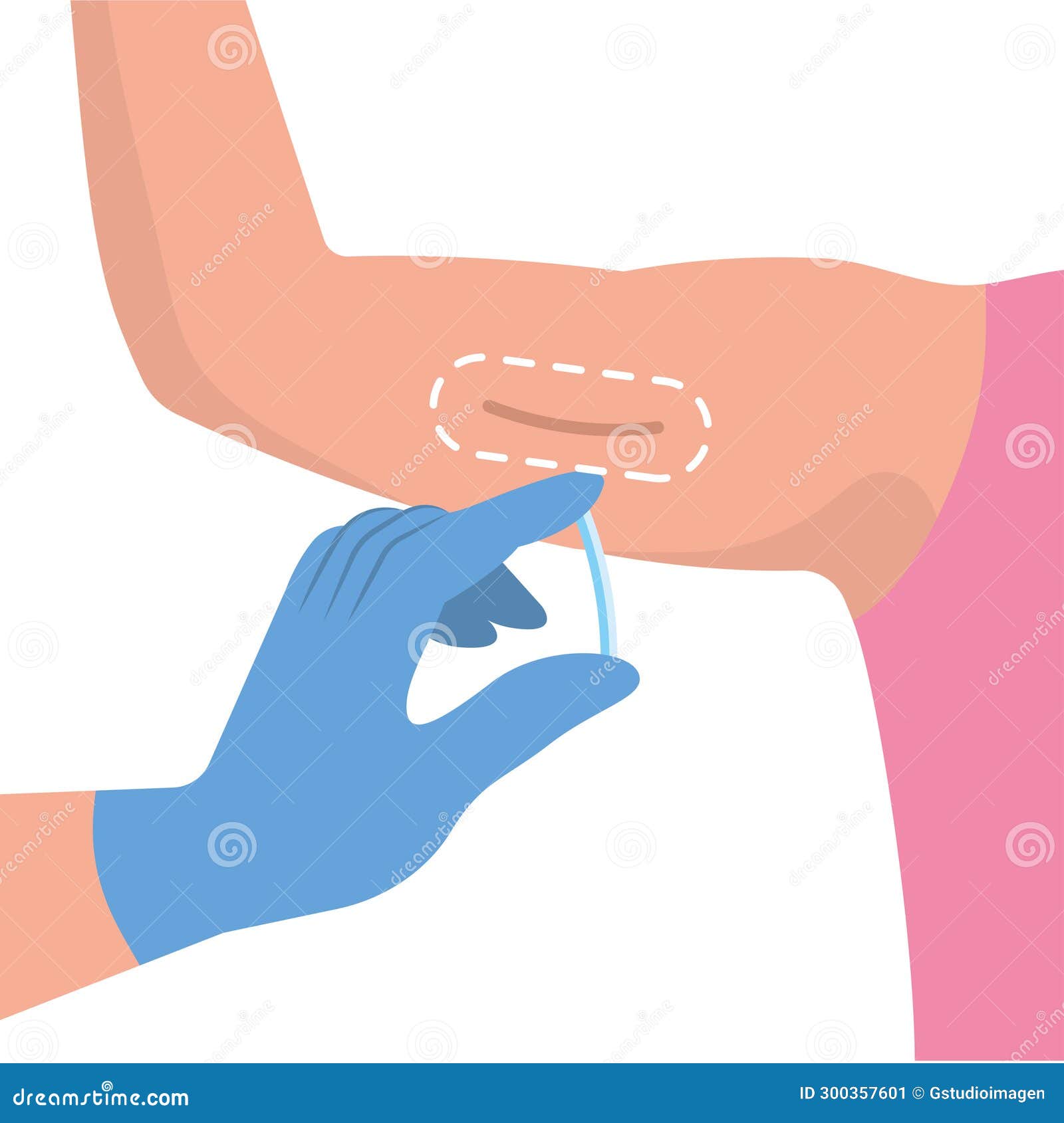 Contraceptive Implant Birth Control Stock Illustration - Illustration ... Contraceptive Implant Birth Control Stock Illustration - Illustration ...