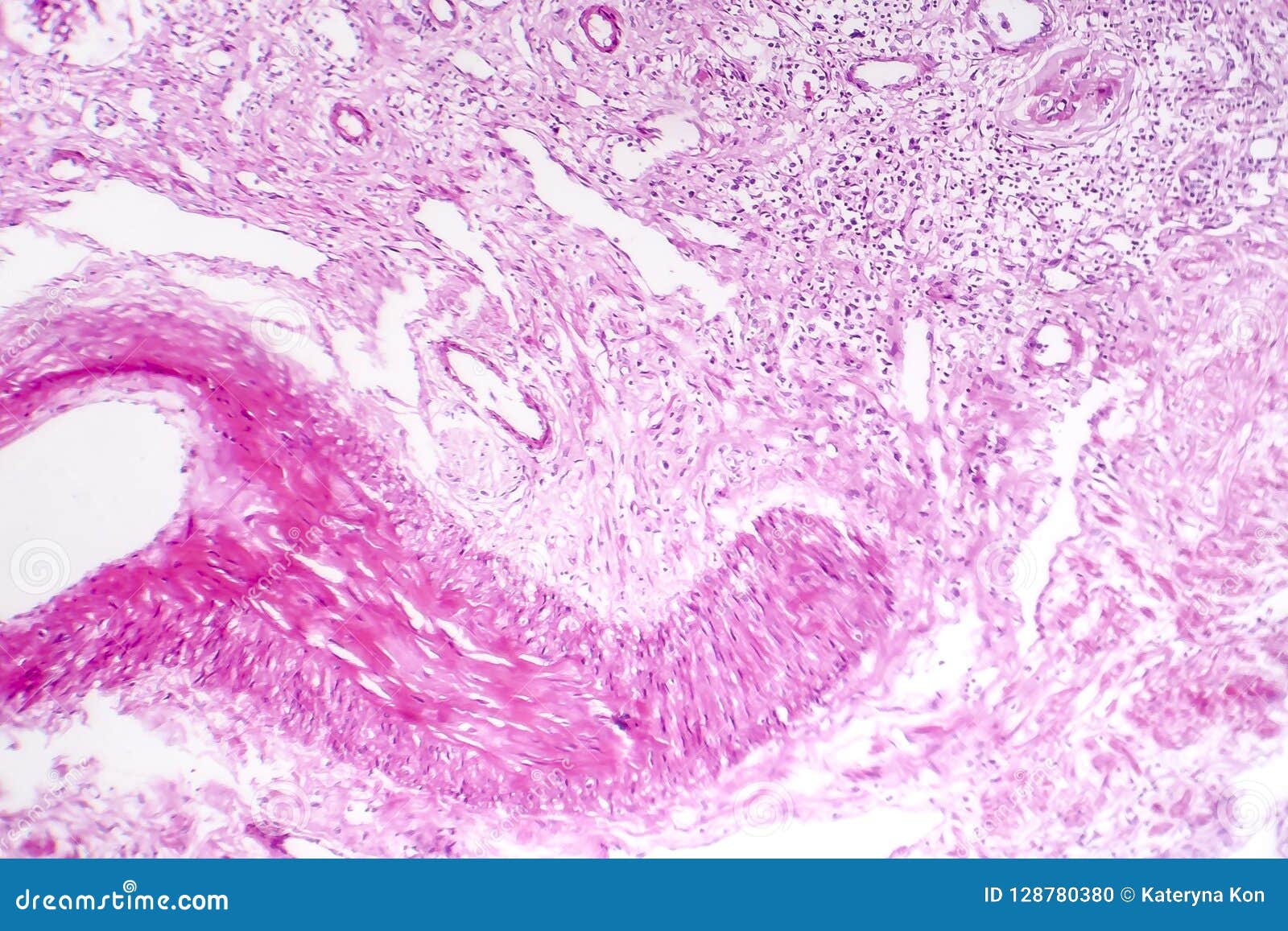 Contracted Kidney, Light Micrograph Stock Photo - Image of medicine ...