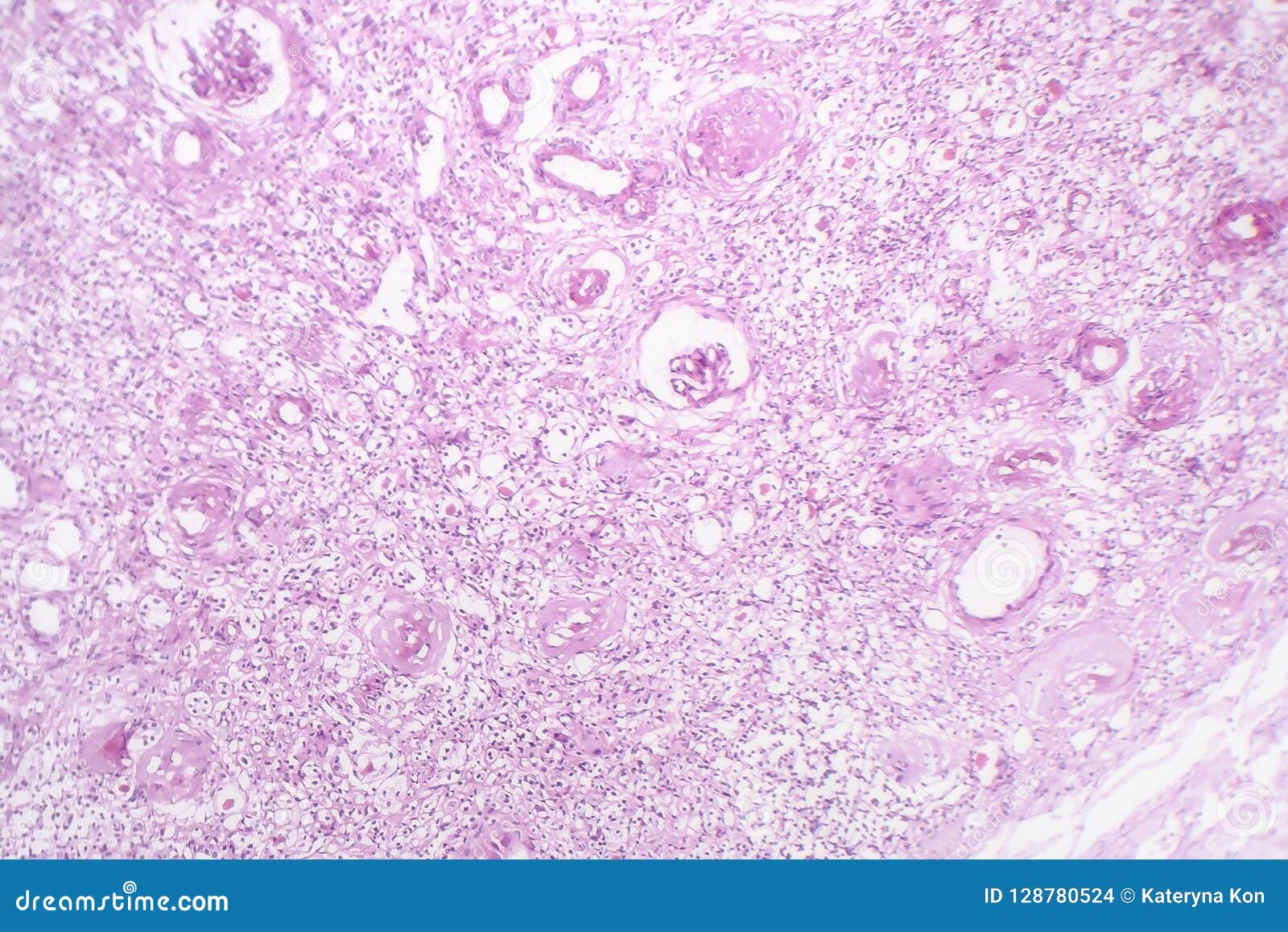 Contracted Kidney, Light Micrograph Stock Photo - Image of glomerular ...