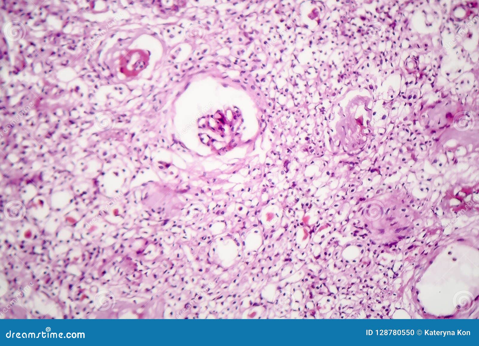 Contracted Kidney, Light Micrograph Stock Photo - Image of ...