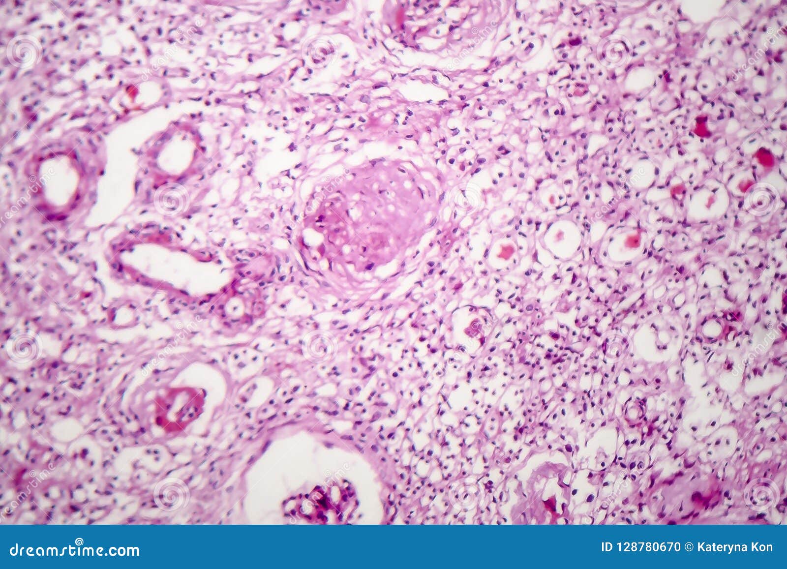 Contracted Kidney, Light Micrograph Stock Photo - Image of micrograph ...