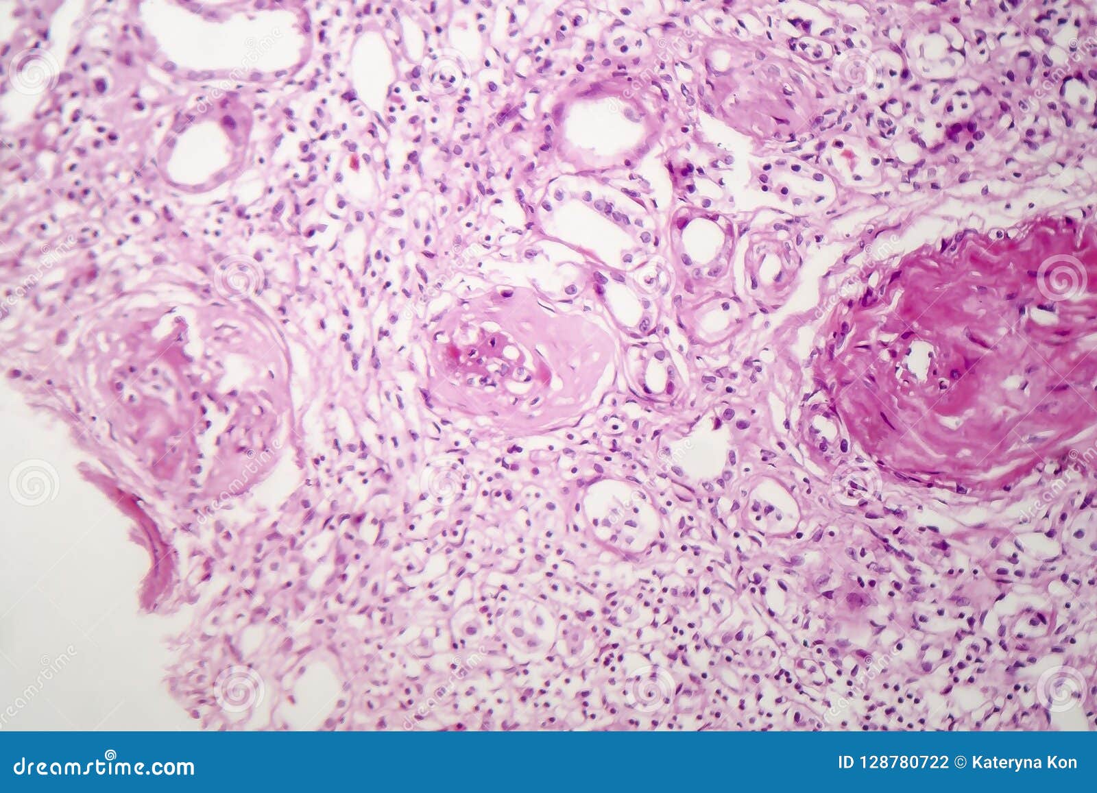 Contracted Kidney, Light Micrograph Stock Photography | CartoonDealer ...